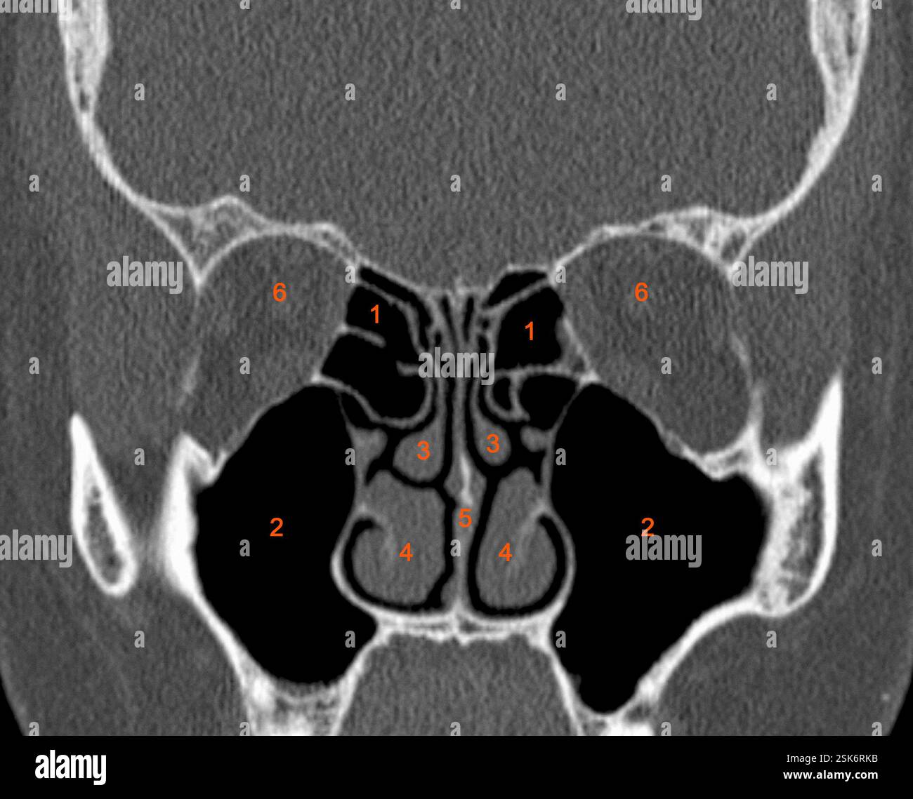 Normal sinuses. Computed tomography (CT) scan of a coronal section ...