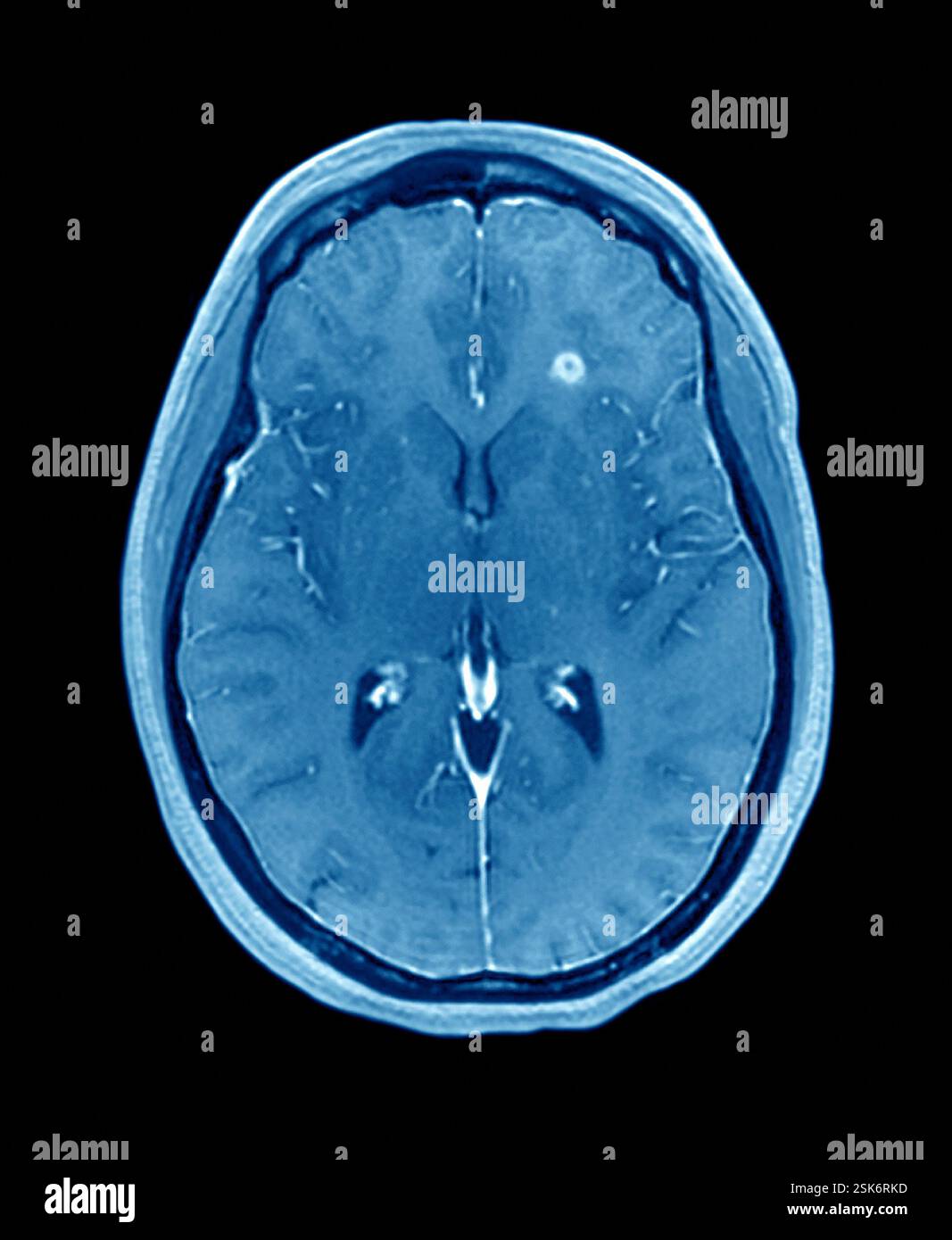 Brain damage due to a stroke, MRI scan Stock Photo - Alamy