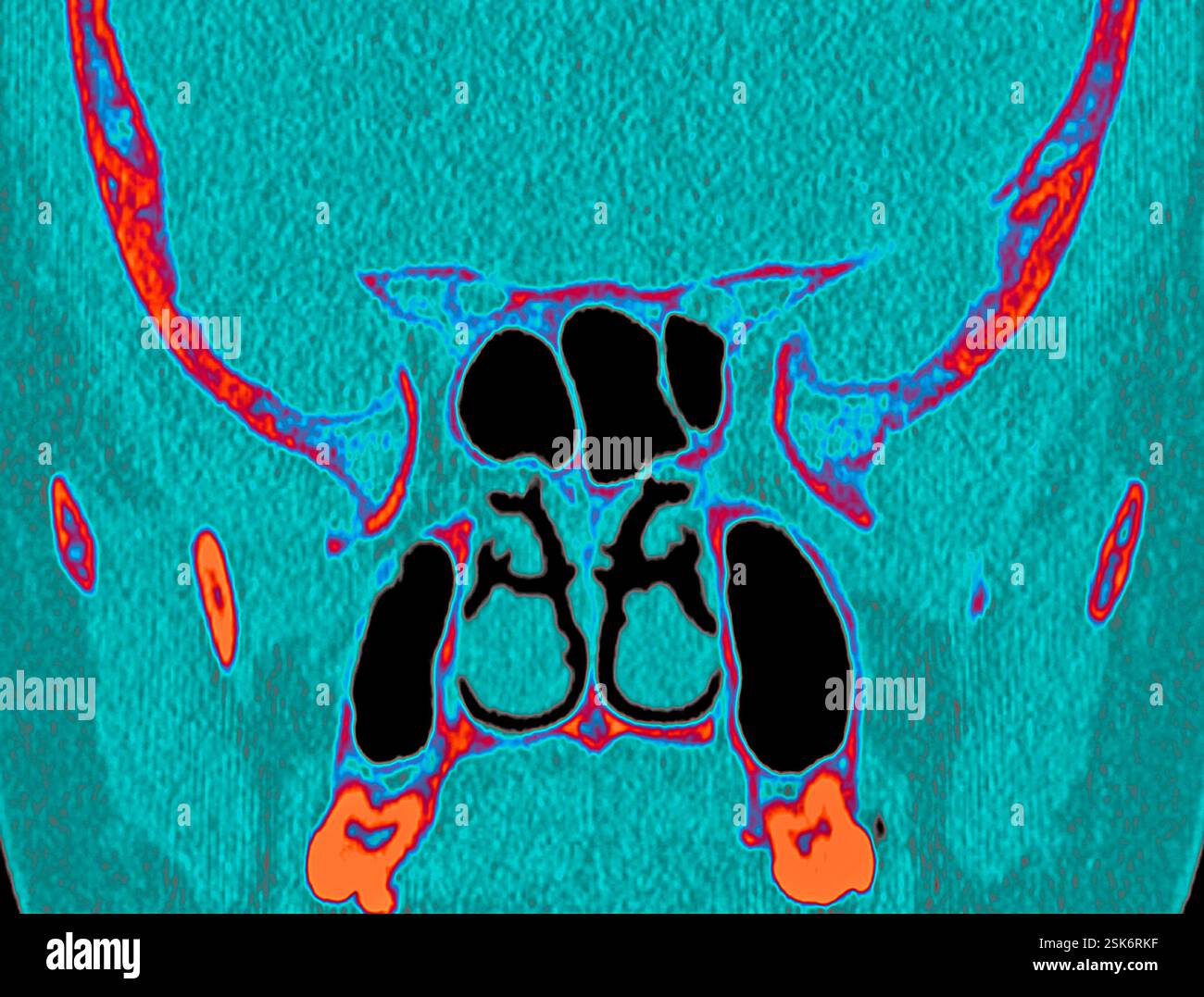 Normal sinuses. Coloured computed tomography (CT) scan of an coronal ...