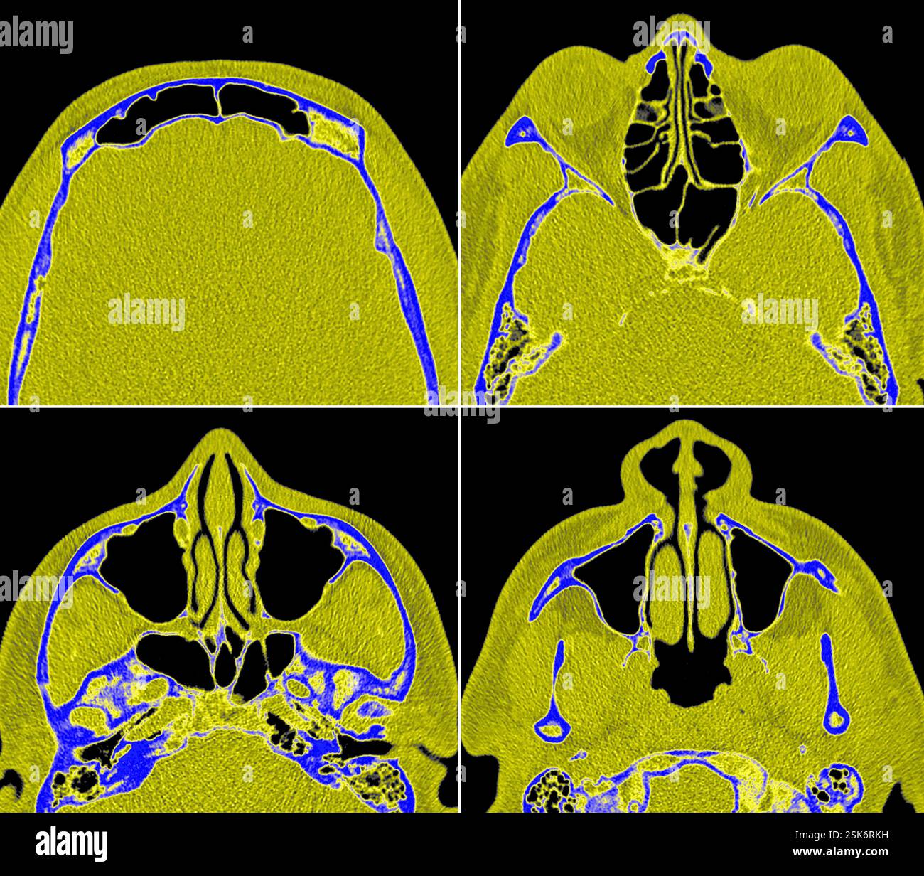 Normal sinuses. Coloured computed tomography (CT) scans of axial ...