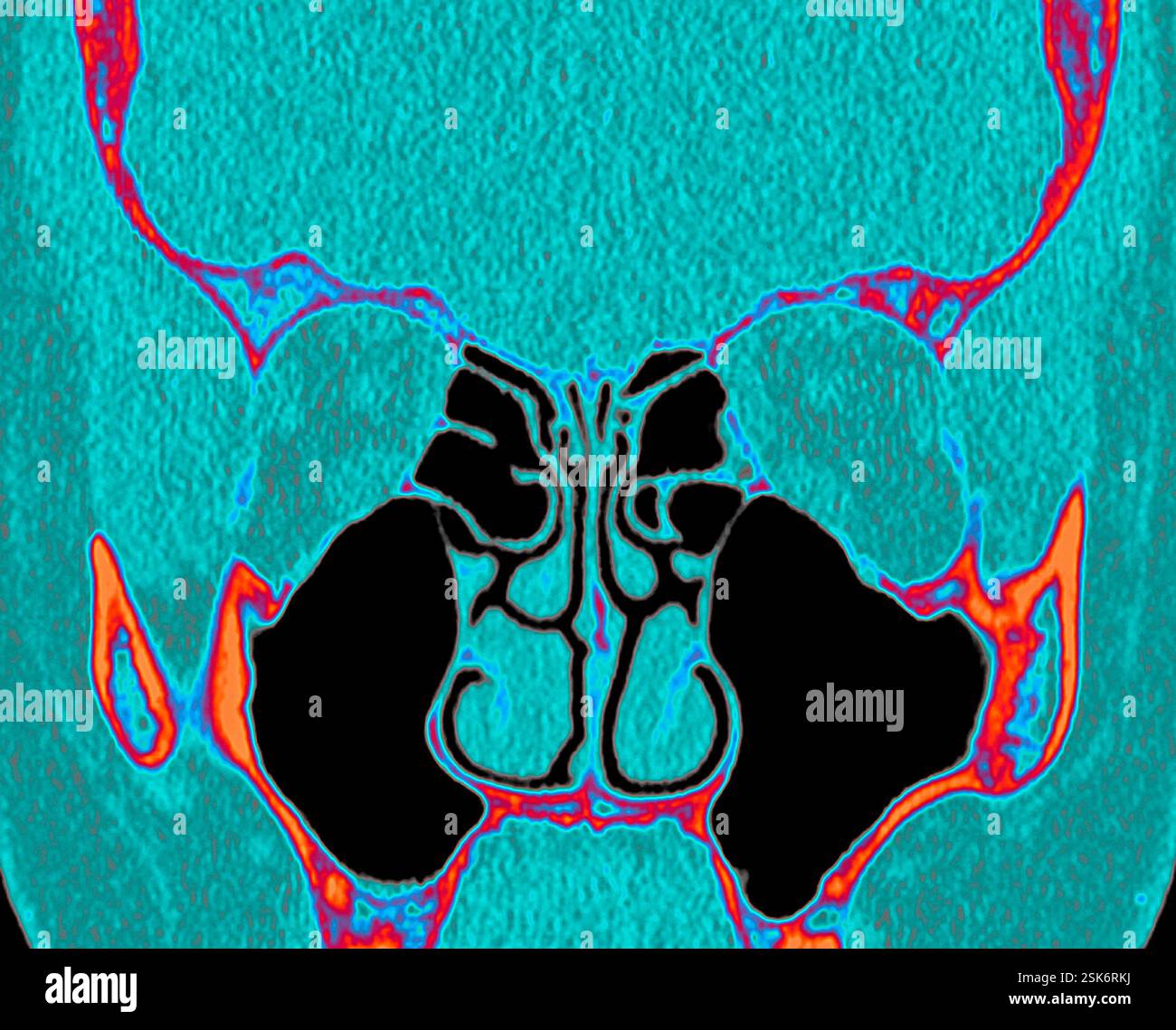 Normal sinuses. Coloured computed tomography (CT) scan of a coronal ...