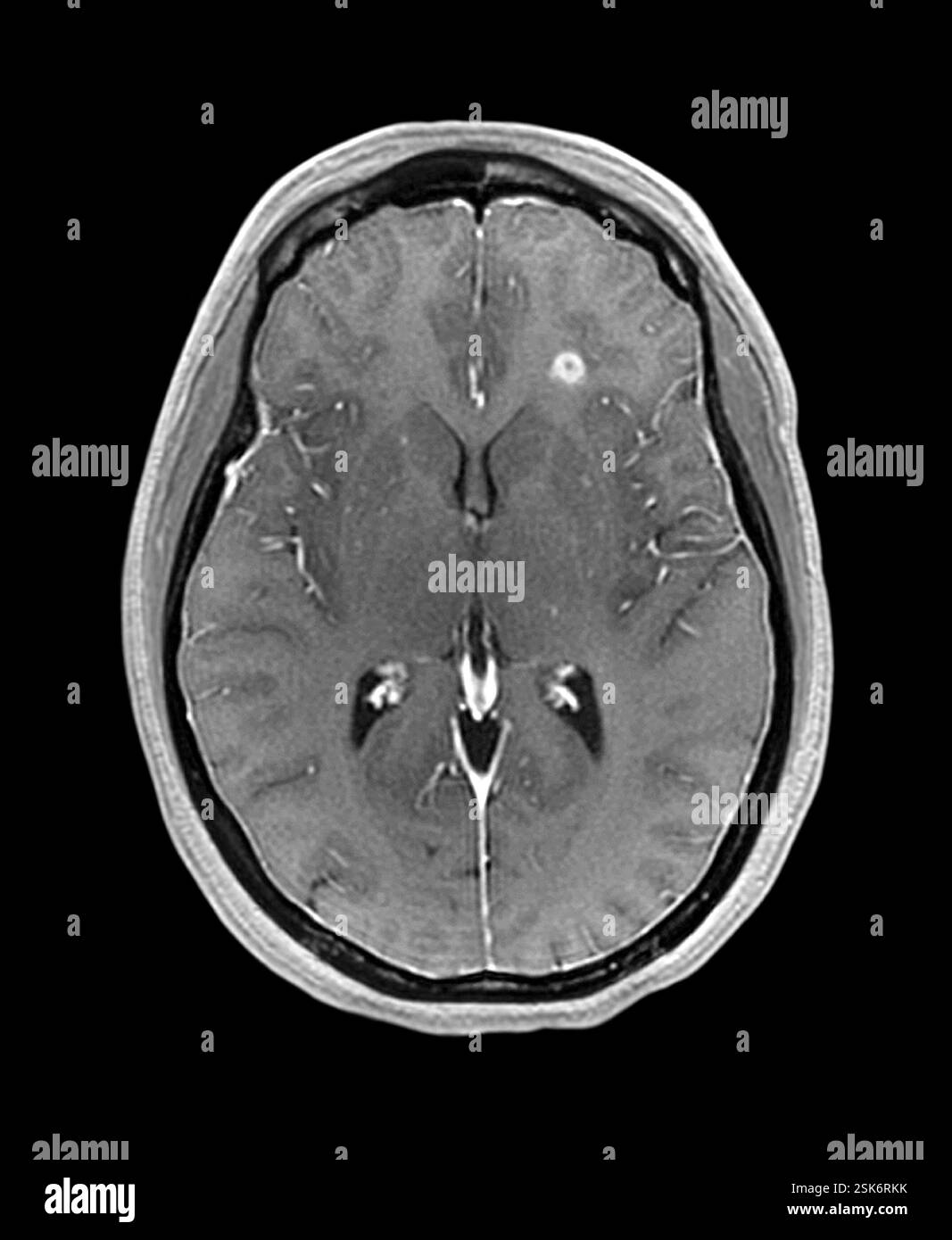 Glioblastoma, CT scan Stock Photo - Alamy