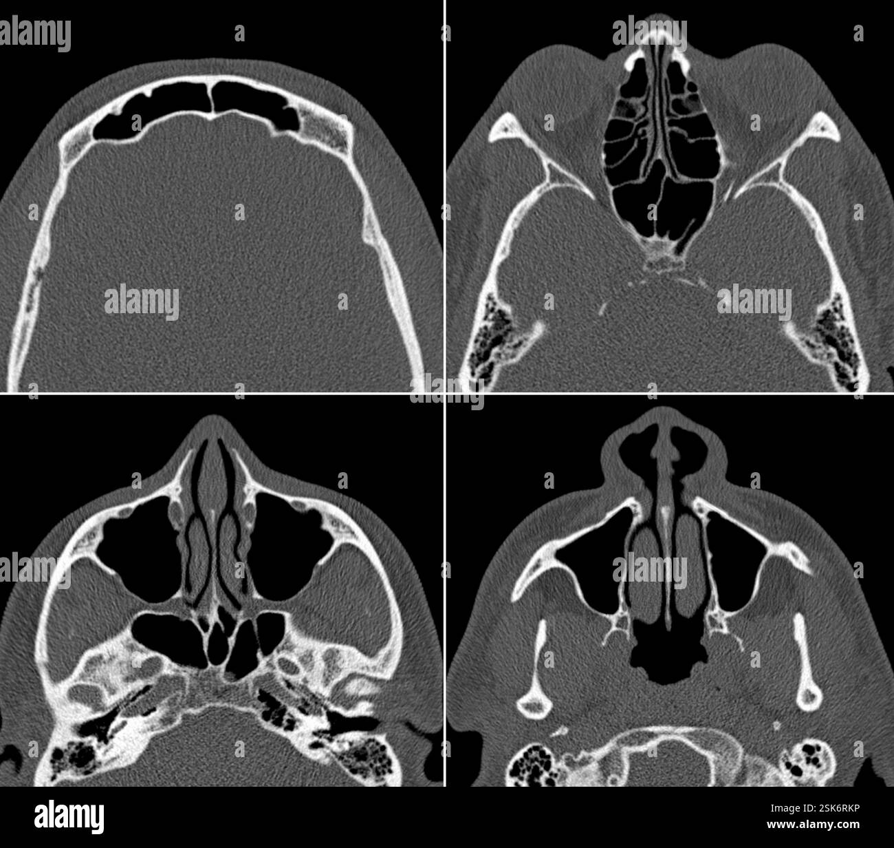 Normal sinuses. Coloured computed tomography (CT) scans of axial sections through the skull ...