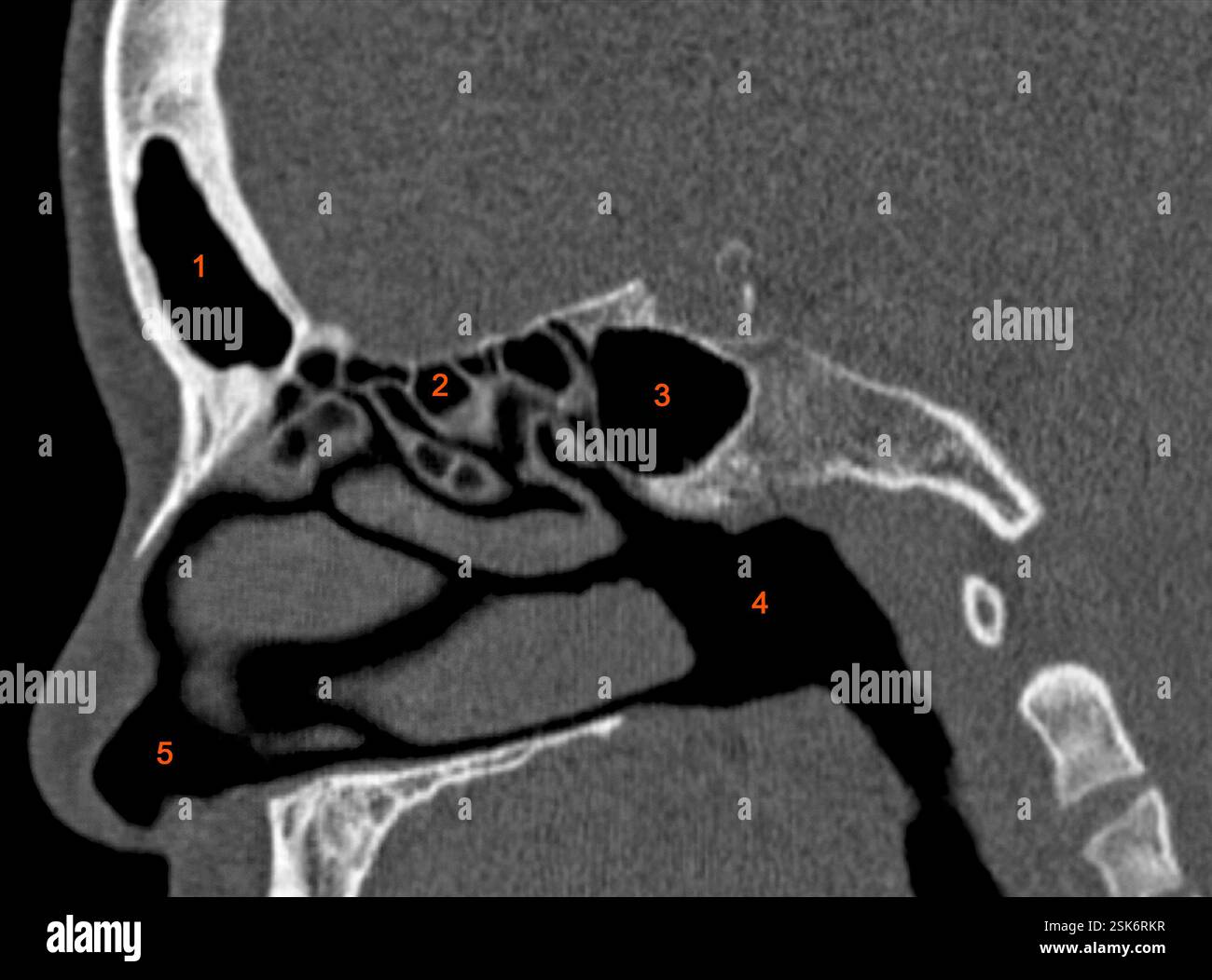 Normal sinuses. Computed tomography (CT) scan of a section through the ...