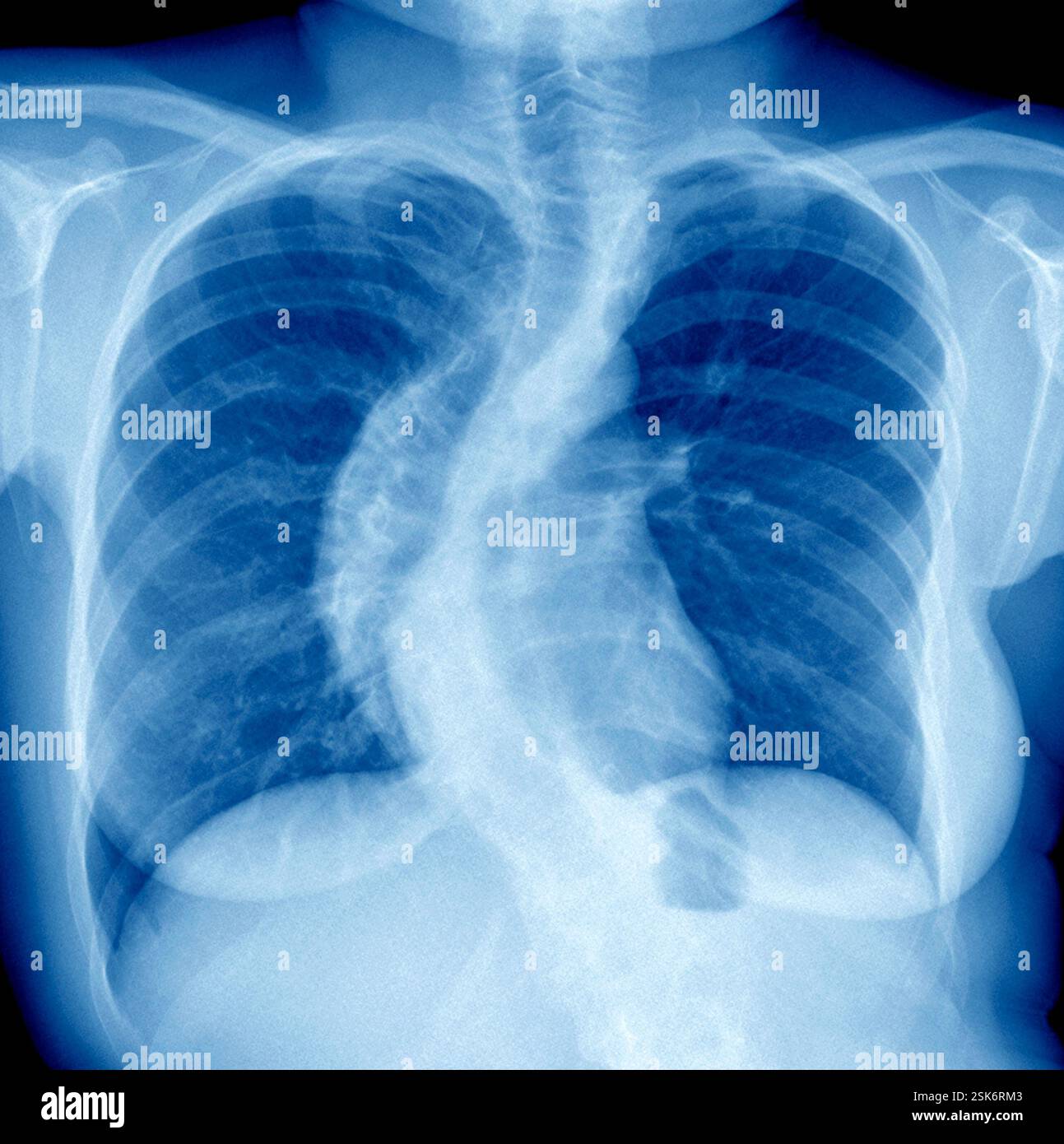Curvature of the spine. Coloured fontal X-ray of a section through the ...