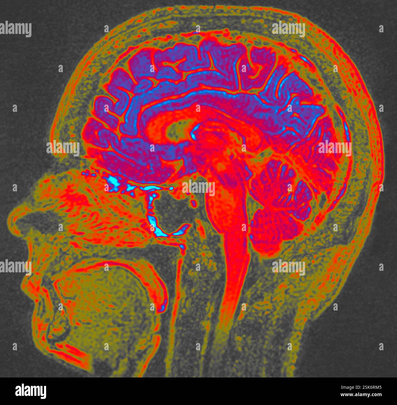 Normal brain. Coloured FLAIR (fluid-attenuated inversion recovery ...