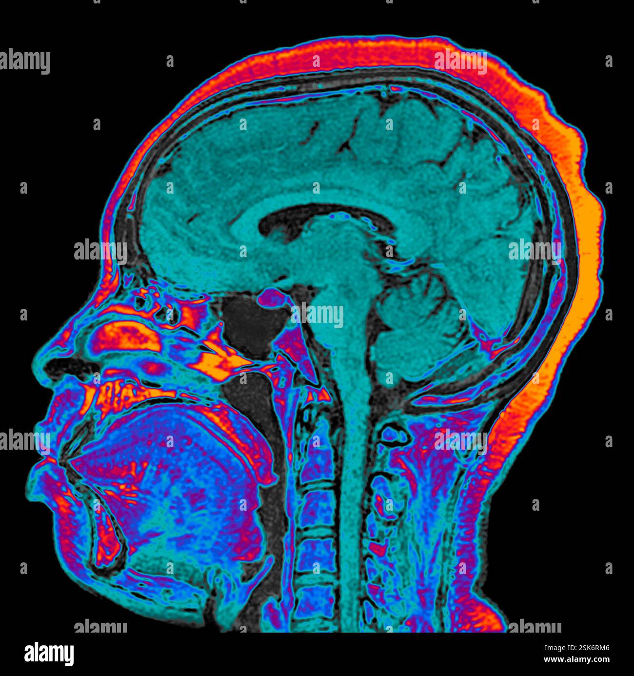 Normal brain. Coloured magnetic resonance imaging (MRI) scan of a sagittal section through the ...