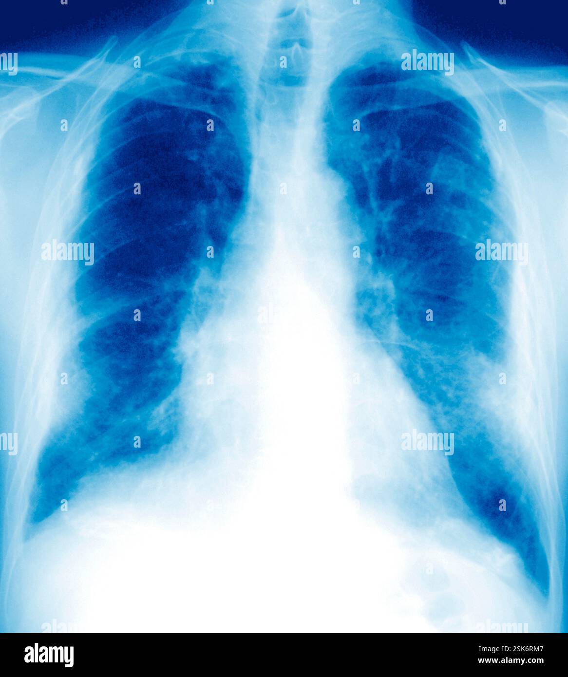 Pleural asbestosis. Frontal chest X-ray of the lungs of a patient with ...