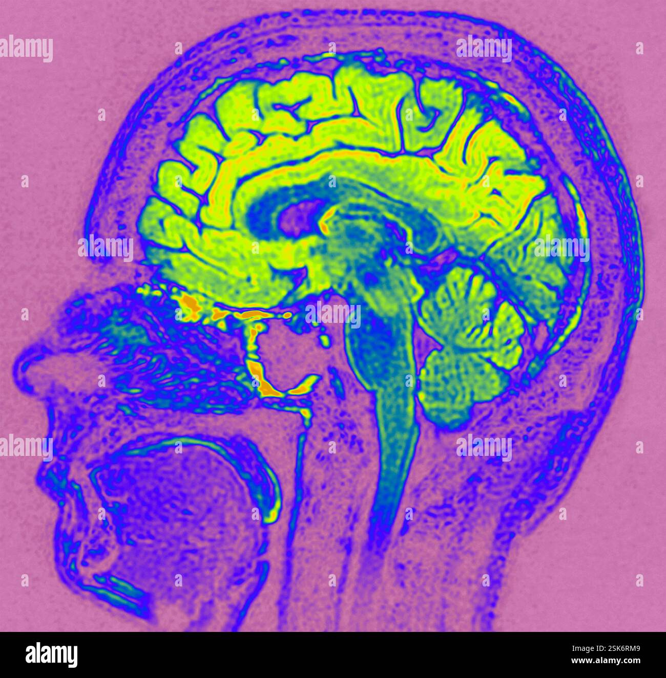 Normal brain. Coloured FLAIR (fluid-attenuated inversion recovery ...