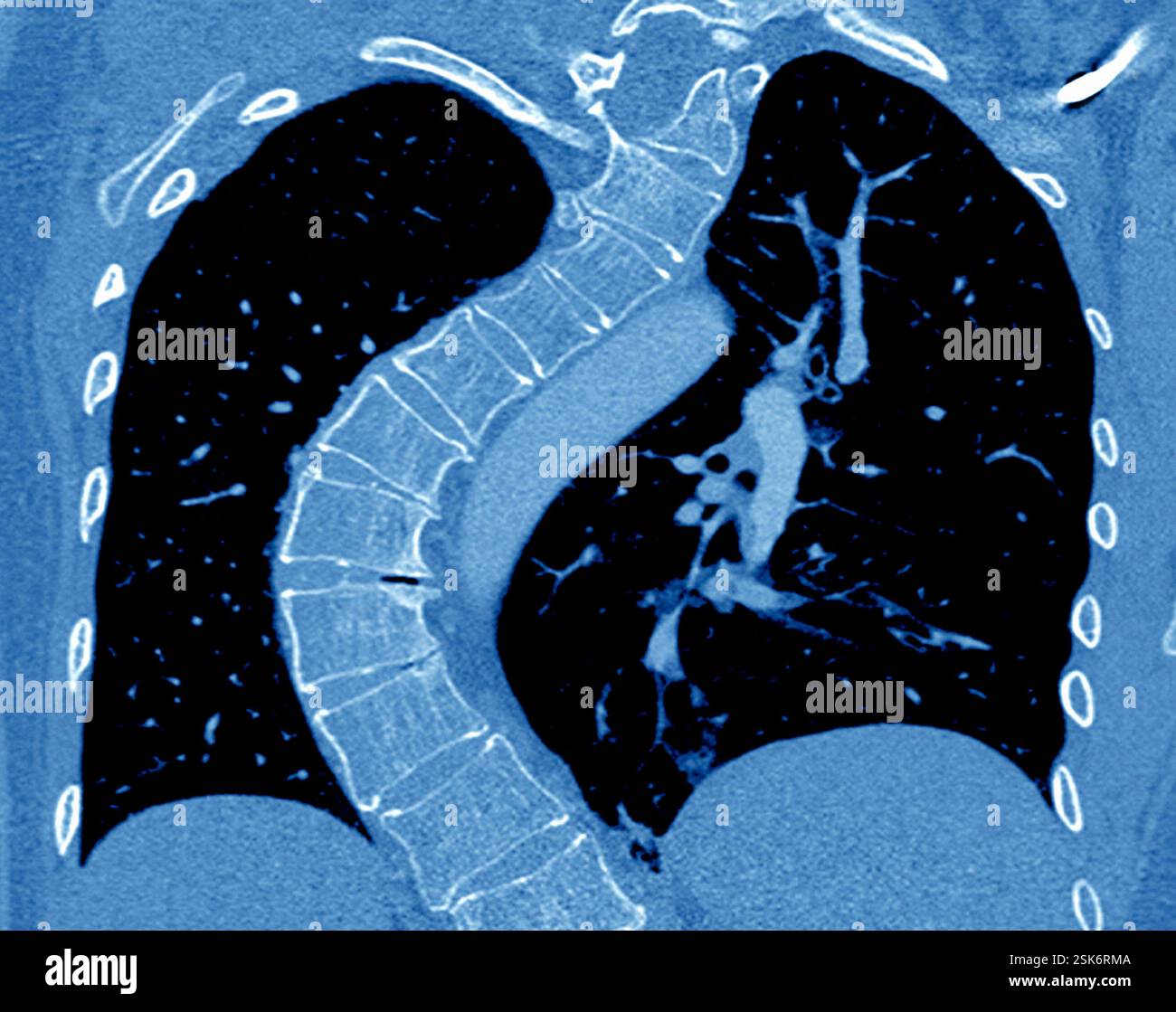 Curvature of the spine. Coloured frontal computed tomography (CT) scan ...