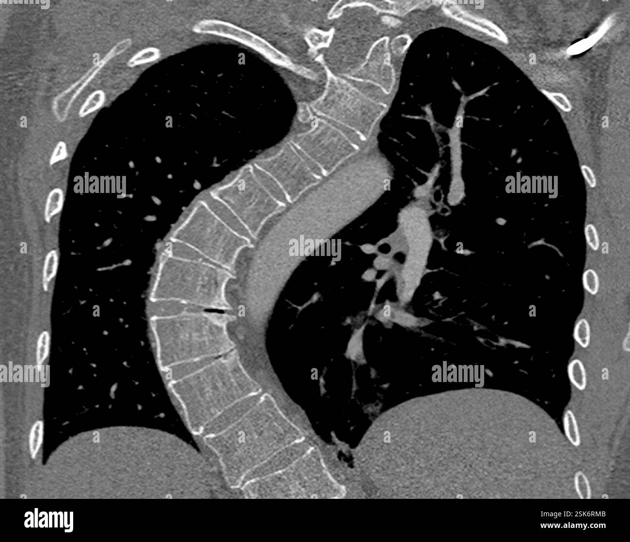 Curvature Of The Spine Frontal Computed Tomography Ct Scan Of A