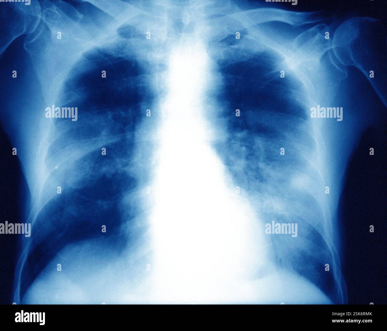 Legionnaires' disease. Coloured frontal chest X- ray of the lungs of a ...