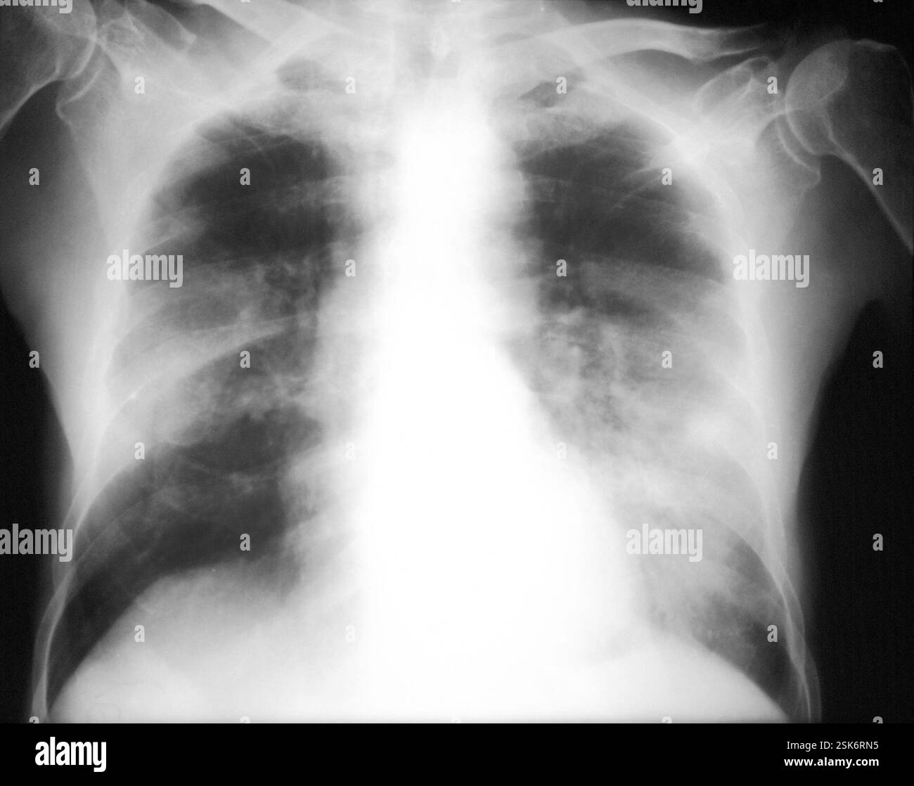 Legionnaires' disease. Frontal chest X-ray of the lungs of a patient ...