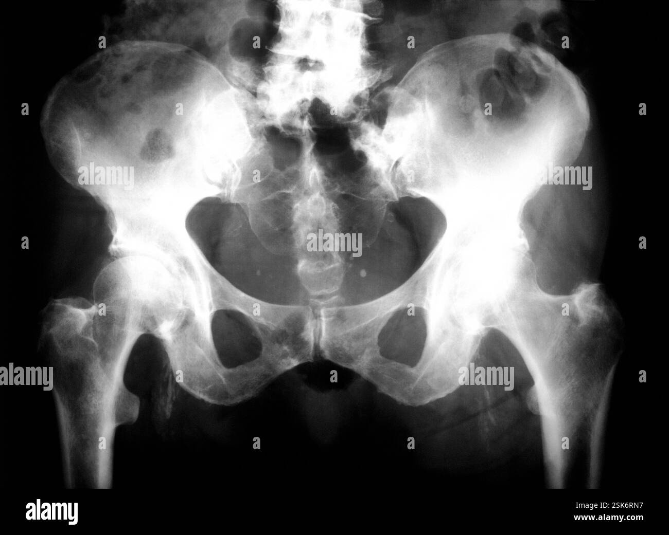 Thrombosis of leg arteries, MRI scan Stock Photo - Alamy