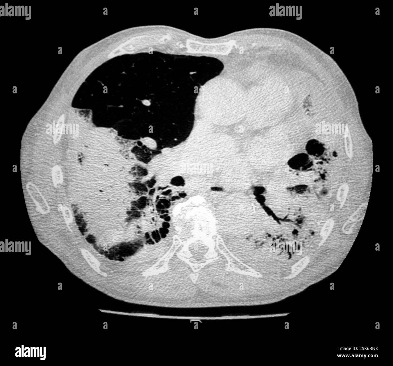 Lung cancer. Axial computer tomography (CT) scan of the lungs of a ...