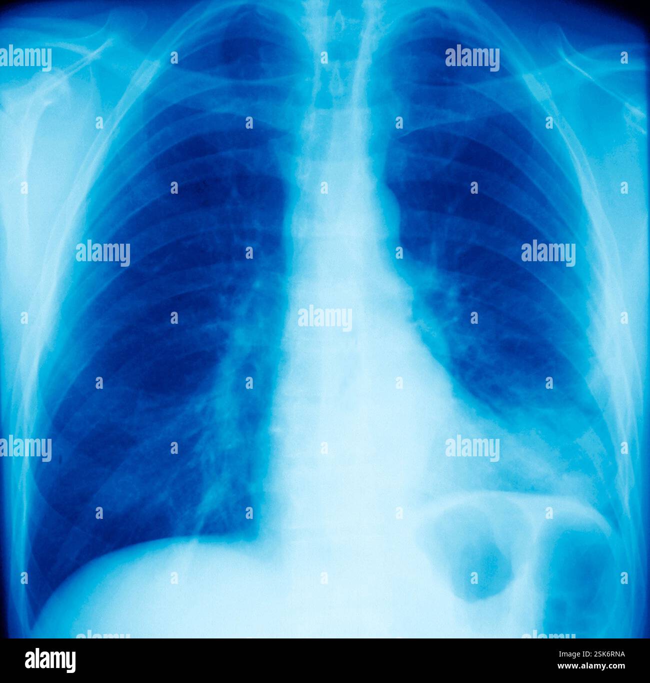 Healthy lungs exhaling, X-ray Stock Photo - Alamy