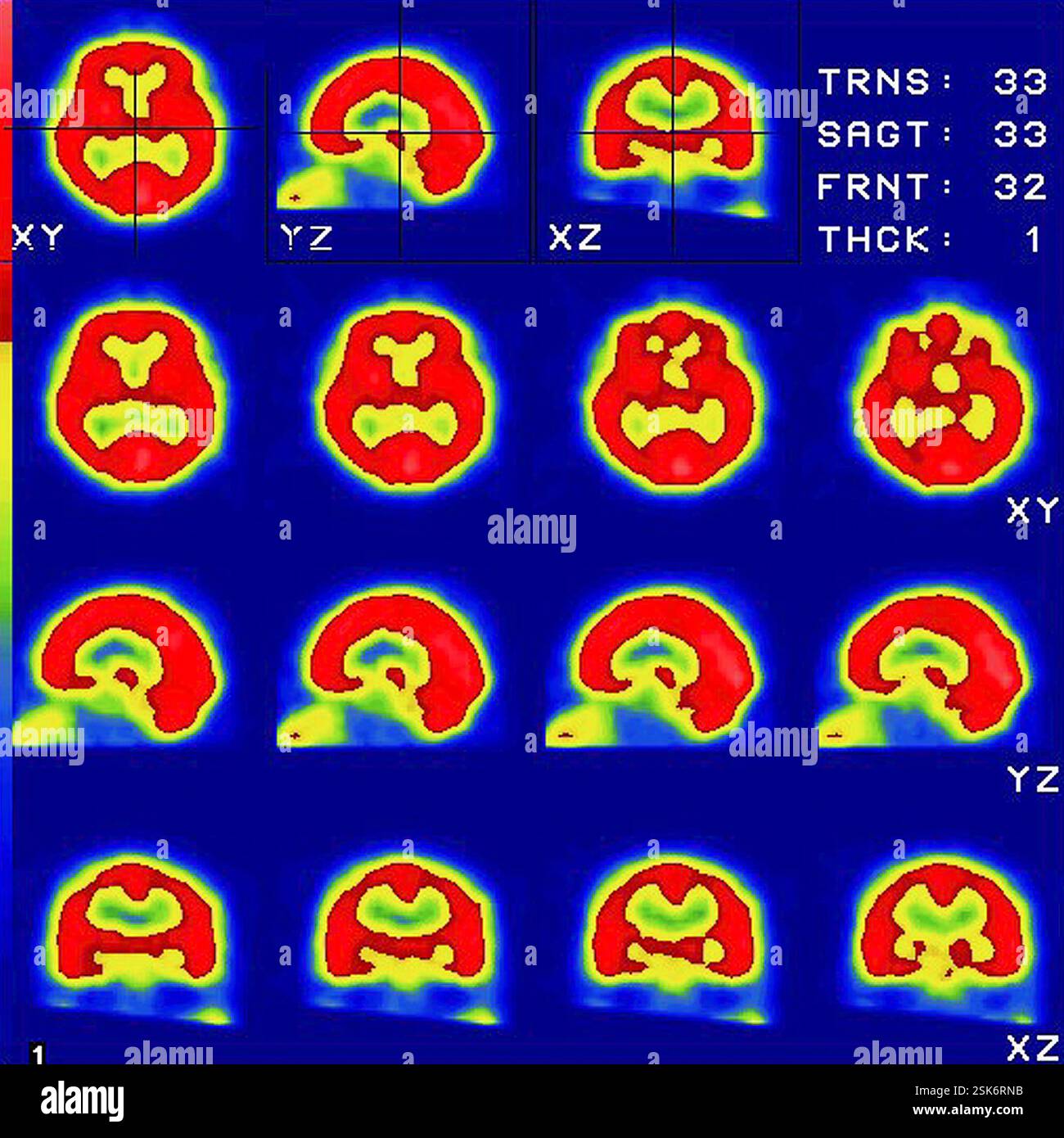 Healthy brain, SPECT scans Stock Photo - Alamy