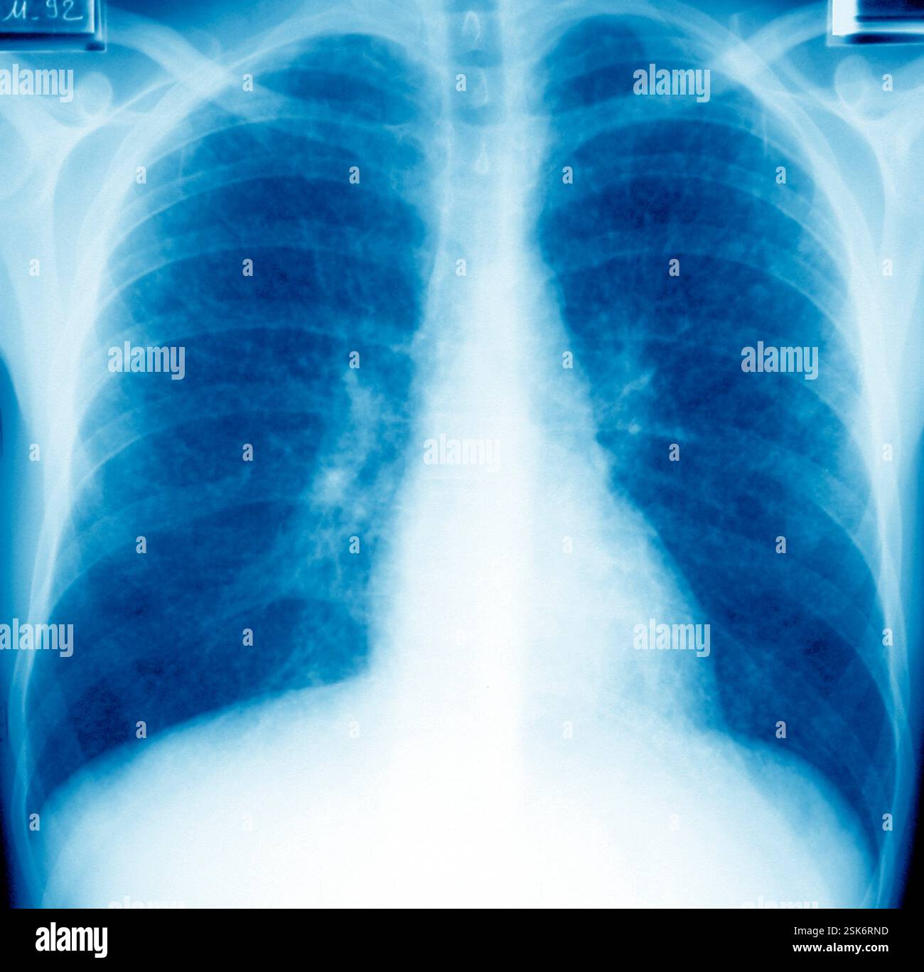Miliary tuberculosis. Coloured frontal chest X-ray of the lungs of a ...