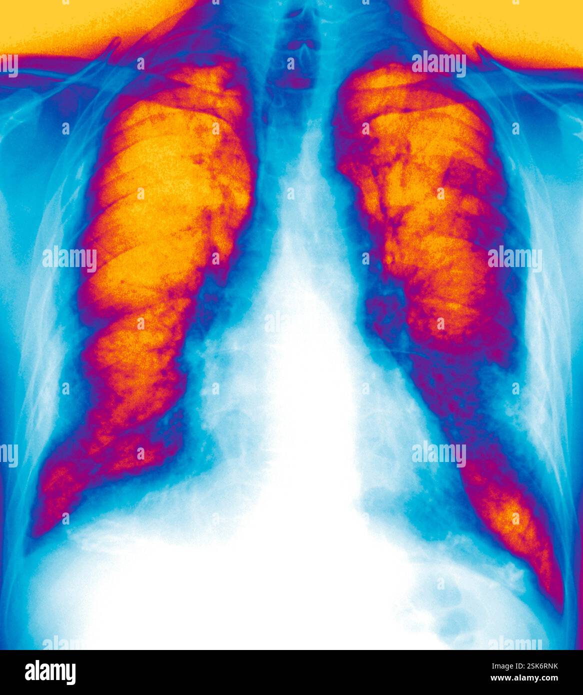 Pleural asbestosis. Frontal chest X-ray of the lungs of a patient with ...