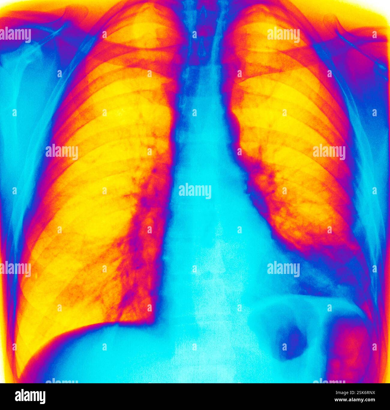 Healthy lungs exhaling, X-ray Stock Photo - Alamy