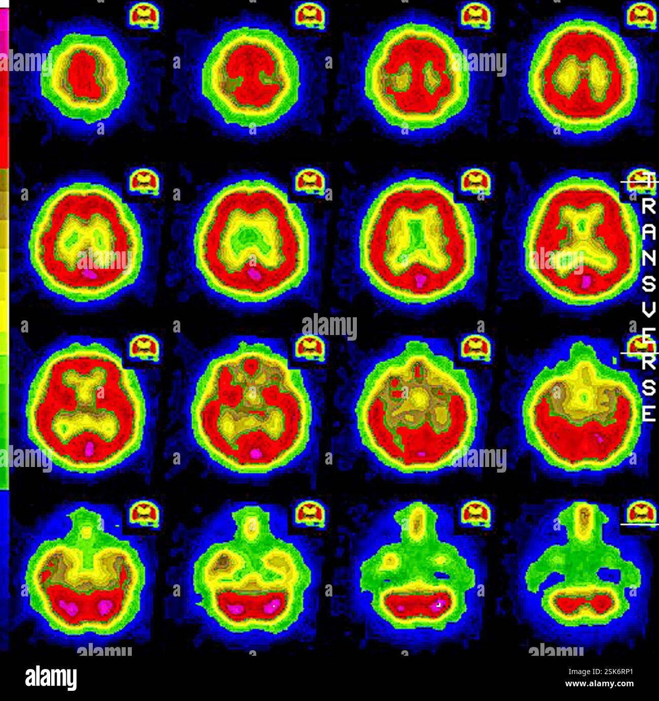 Healthy brain. Coloured single photon emission computed tomography (SPECT) scans of axial ...