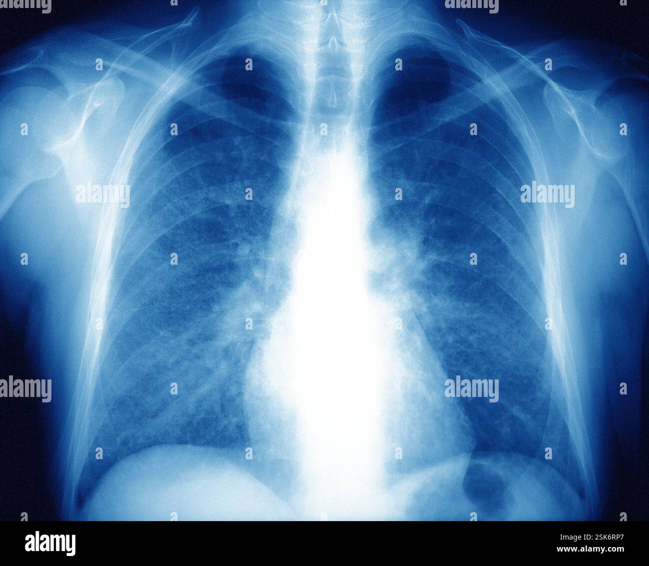 Healthy lungs inhaling, X-ray Stock Photo - Alamy