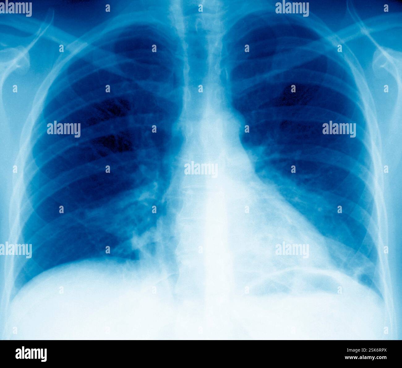 Legionnaires' disease. Frontal chest X-ray of the lungs of a patient ...