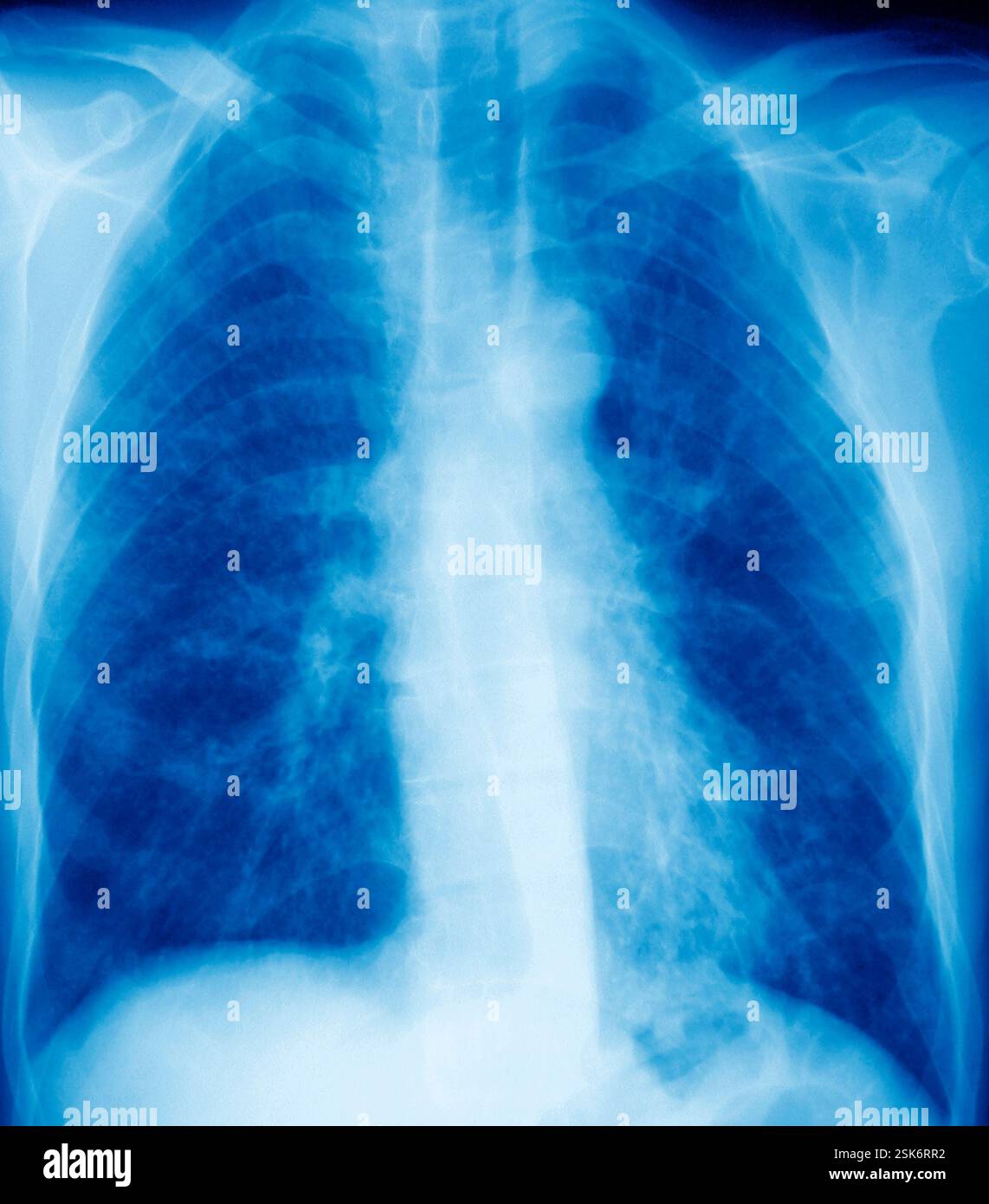 Bronchopneumonia. Frontal chest X-ray of the cloudy lungs of a patient ...