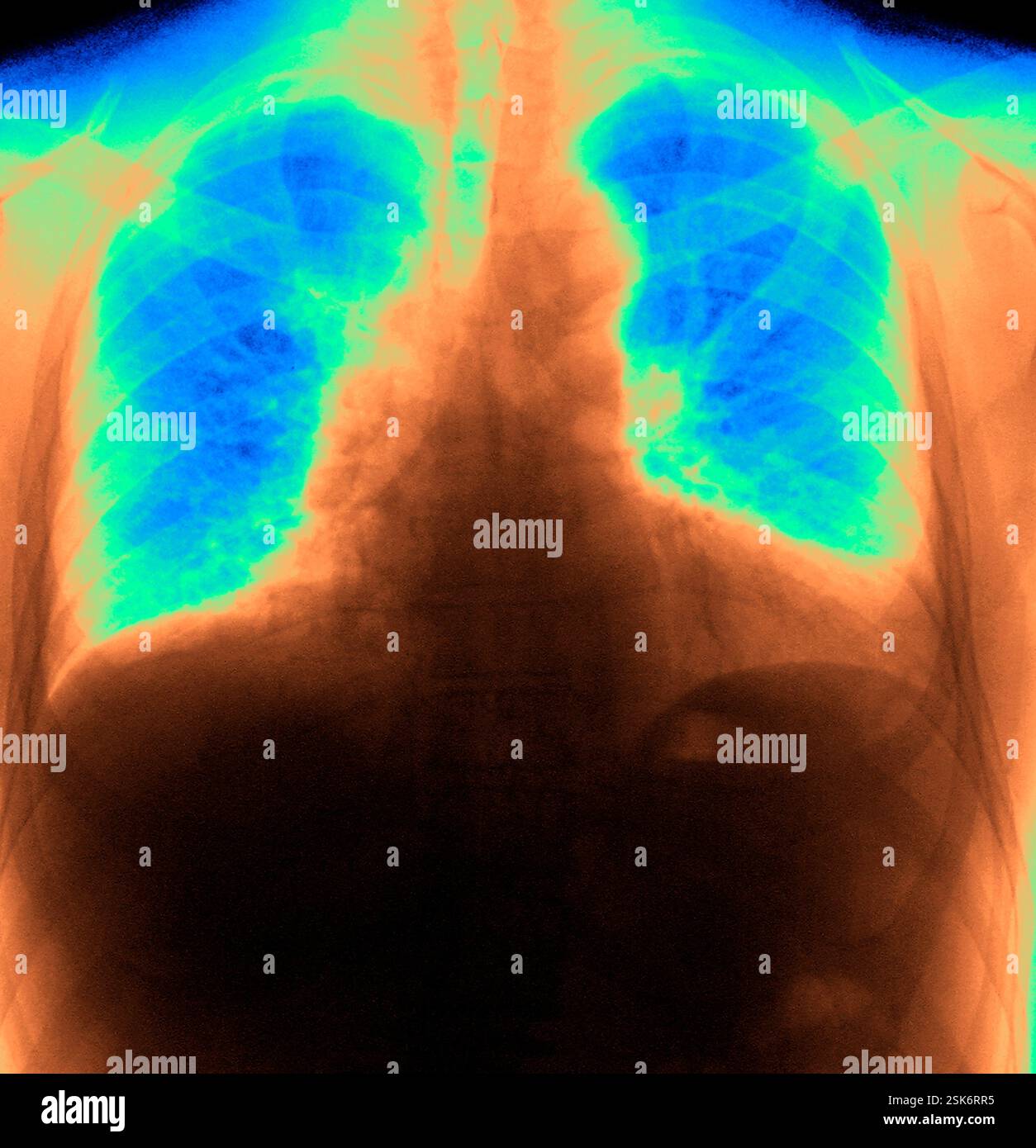 Healthy lungs exhaling. Frontal chest X-ray of healthy lungs (green ...