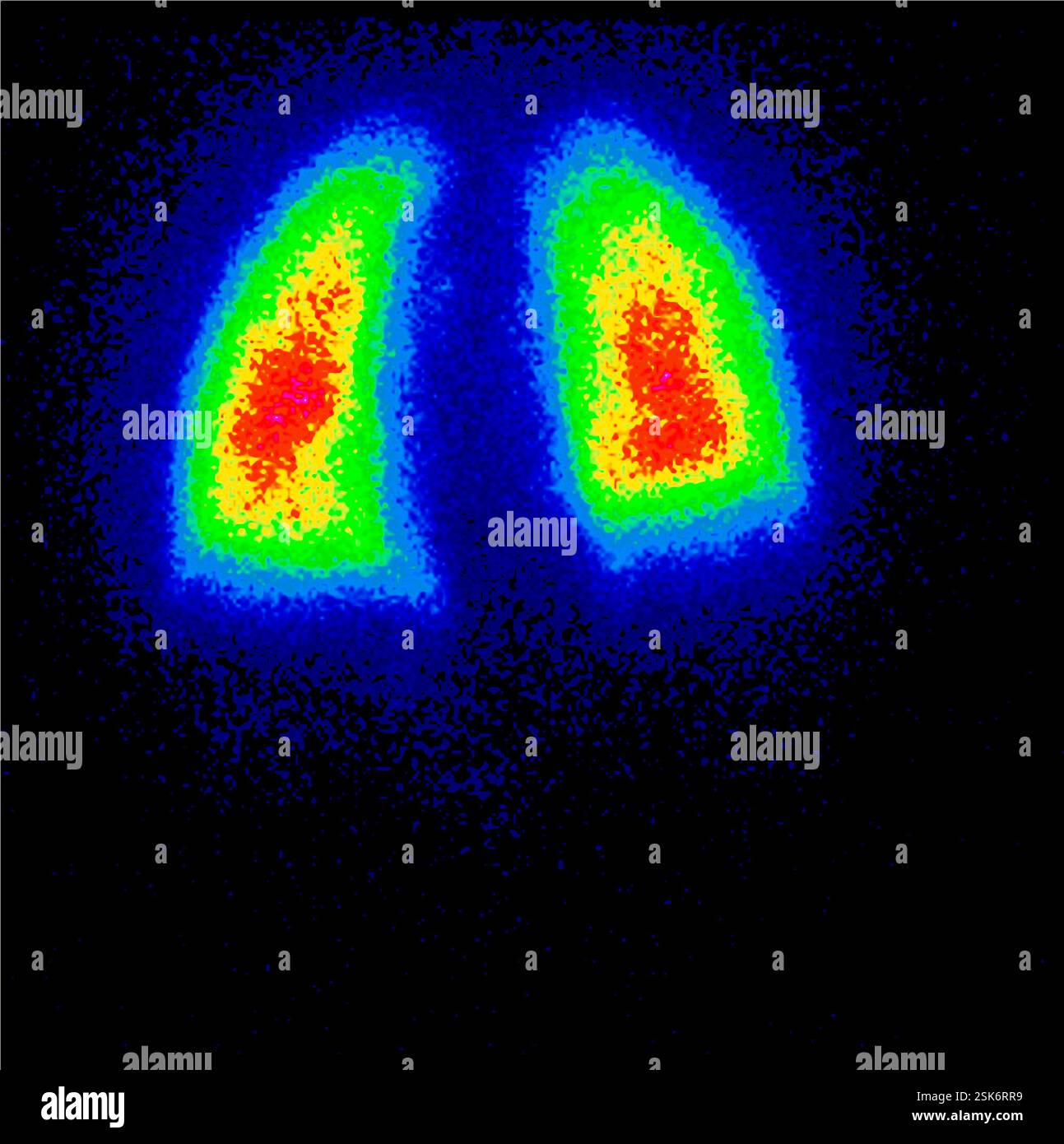 Healthy lung muscle. Scintigram showing blood flow through healthy lung ...