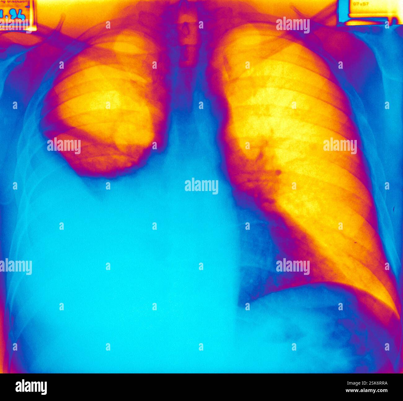 Pleurisy. Coloured frontal chest X-ray of a patient with pleurisy, an ...