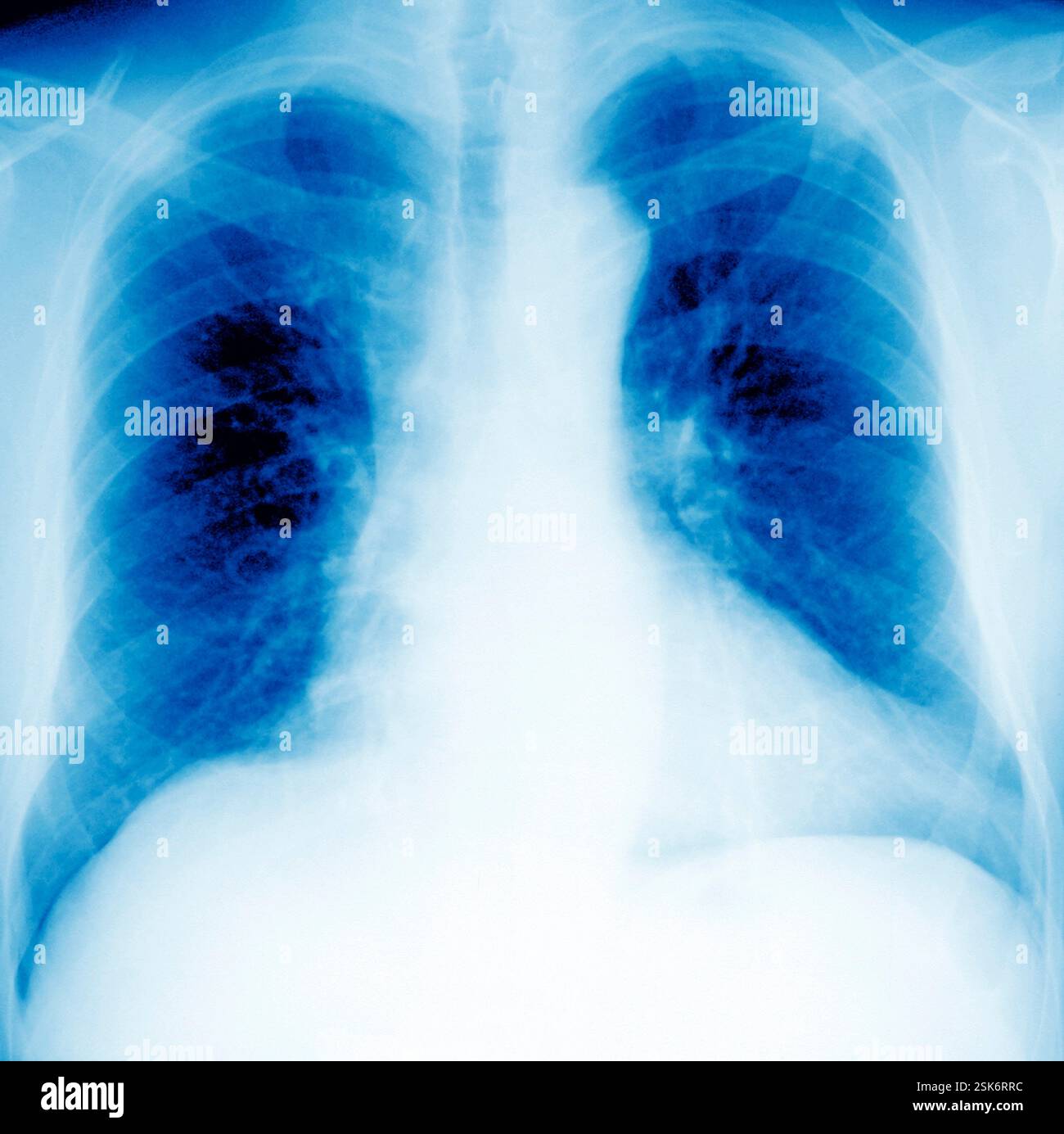 Healthy lungs inhaling. Frontal chest X-ray of healthy lungs (black ...