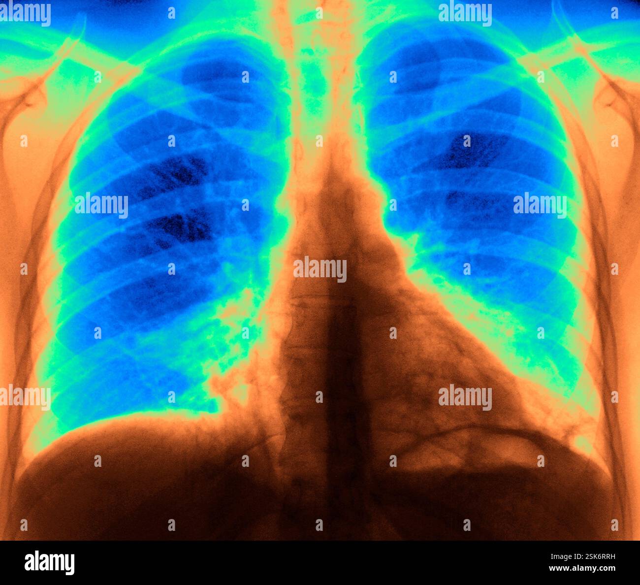 Legionnaires' disease. Frontal chest X-ray of the lungs of a patient ...