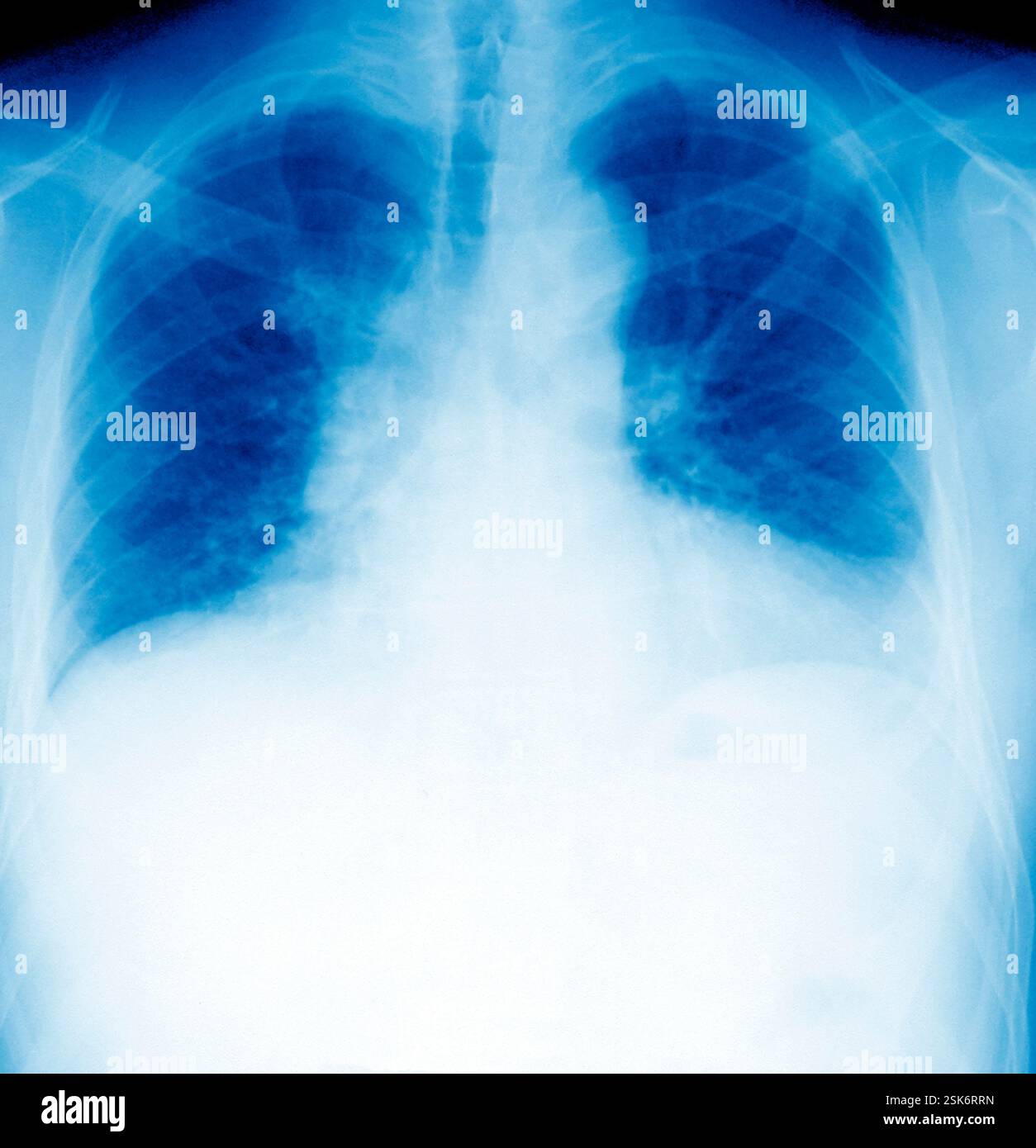 Healthy lungs exhaling, X-ray Stock Photo - Alamy