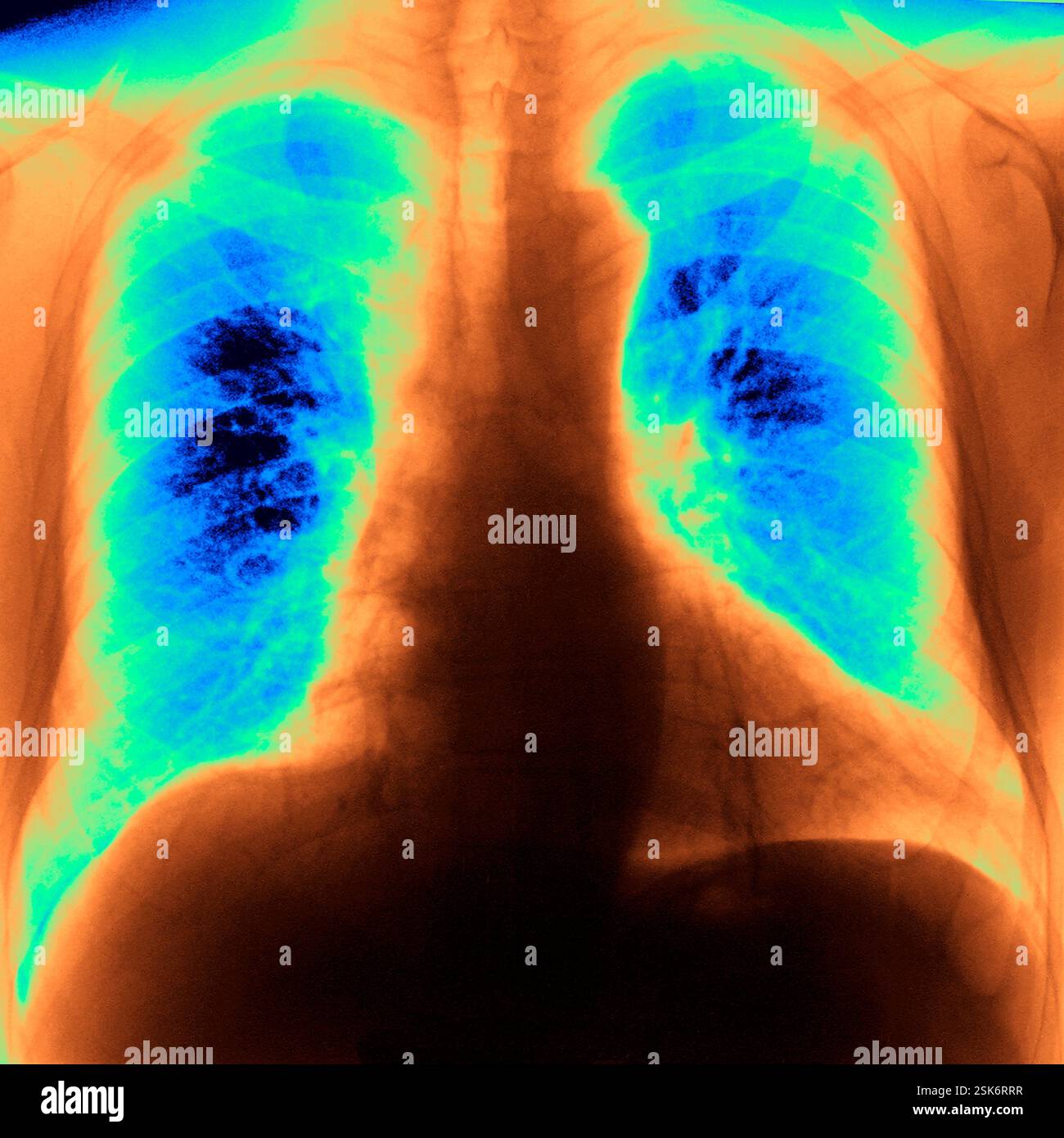 Healthy lungs inhaling, X-ray Stock Photo - Alamy