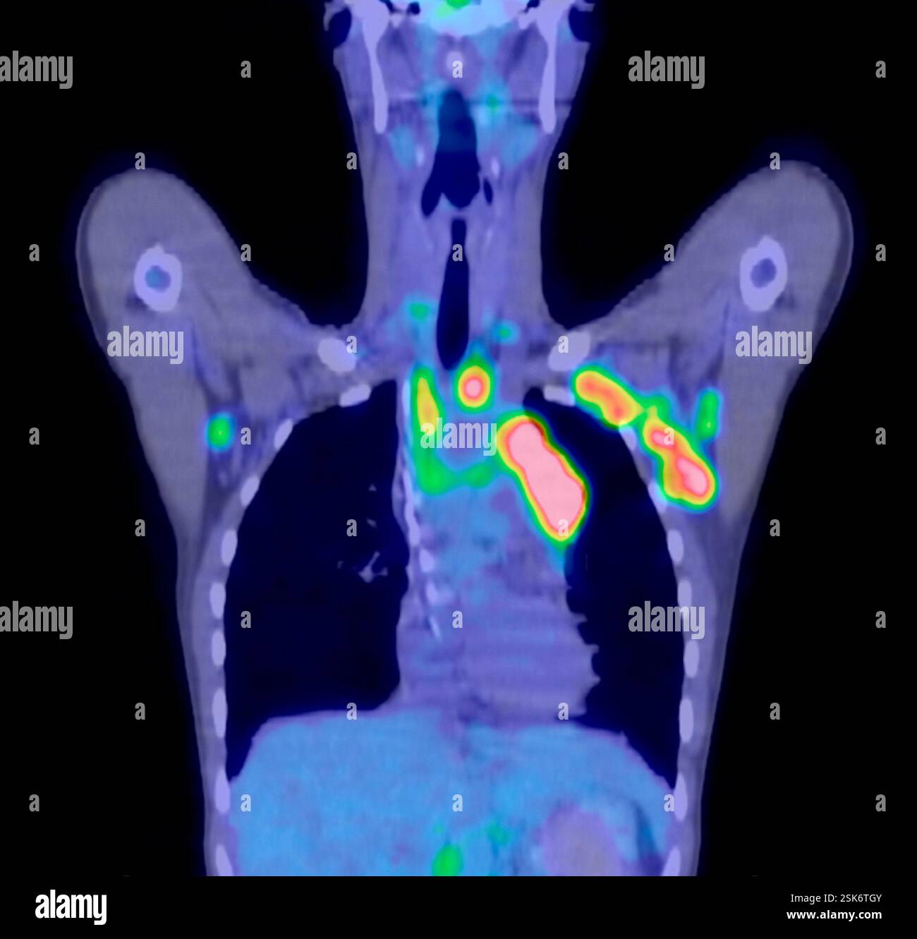 Hodgkin's lymphoma. Image 1 of 2. Combined computed tomography (CT) and ...