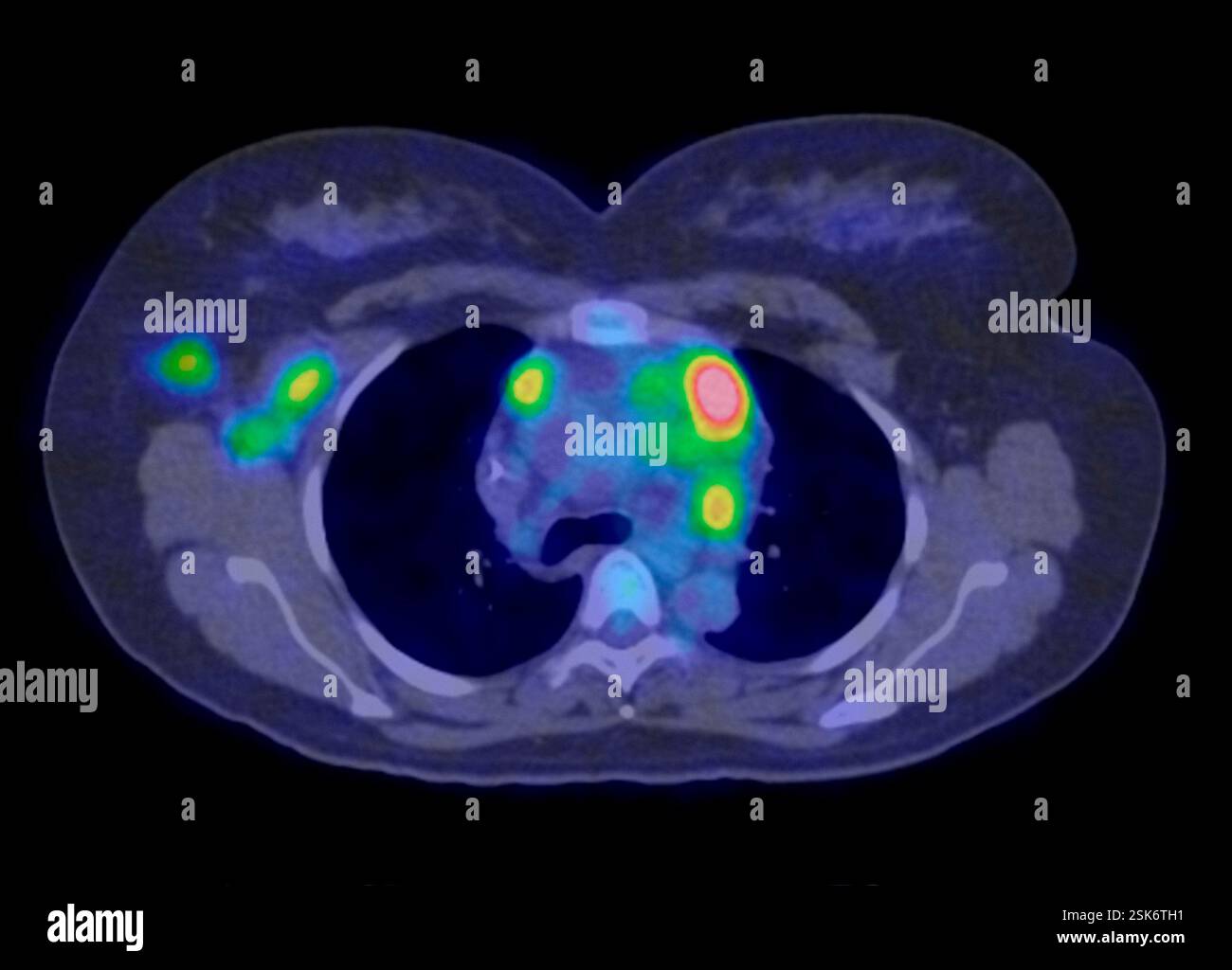Hodgkin's lymphoma, PET scan Stock Photo - Alamy