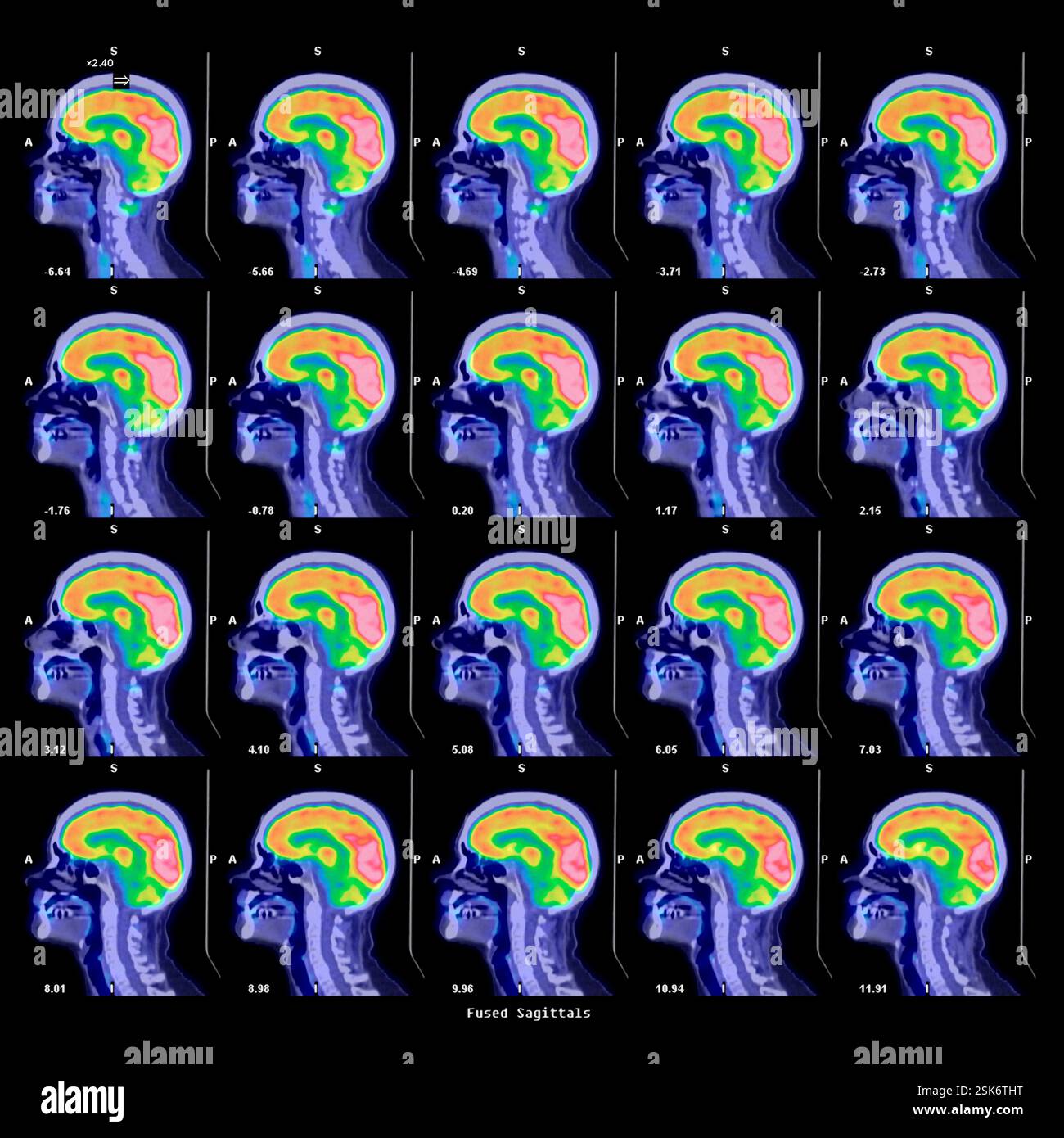 Human brain, combined computed tomography (CT) and positron emission ...