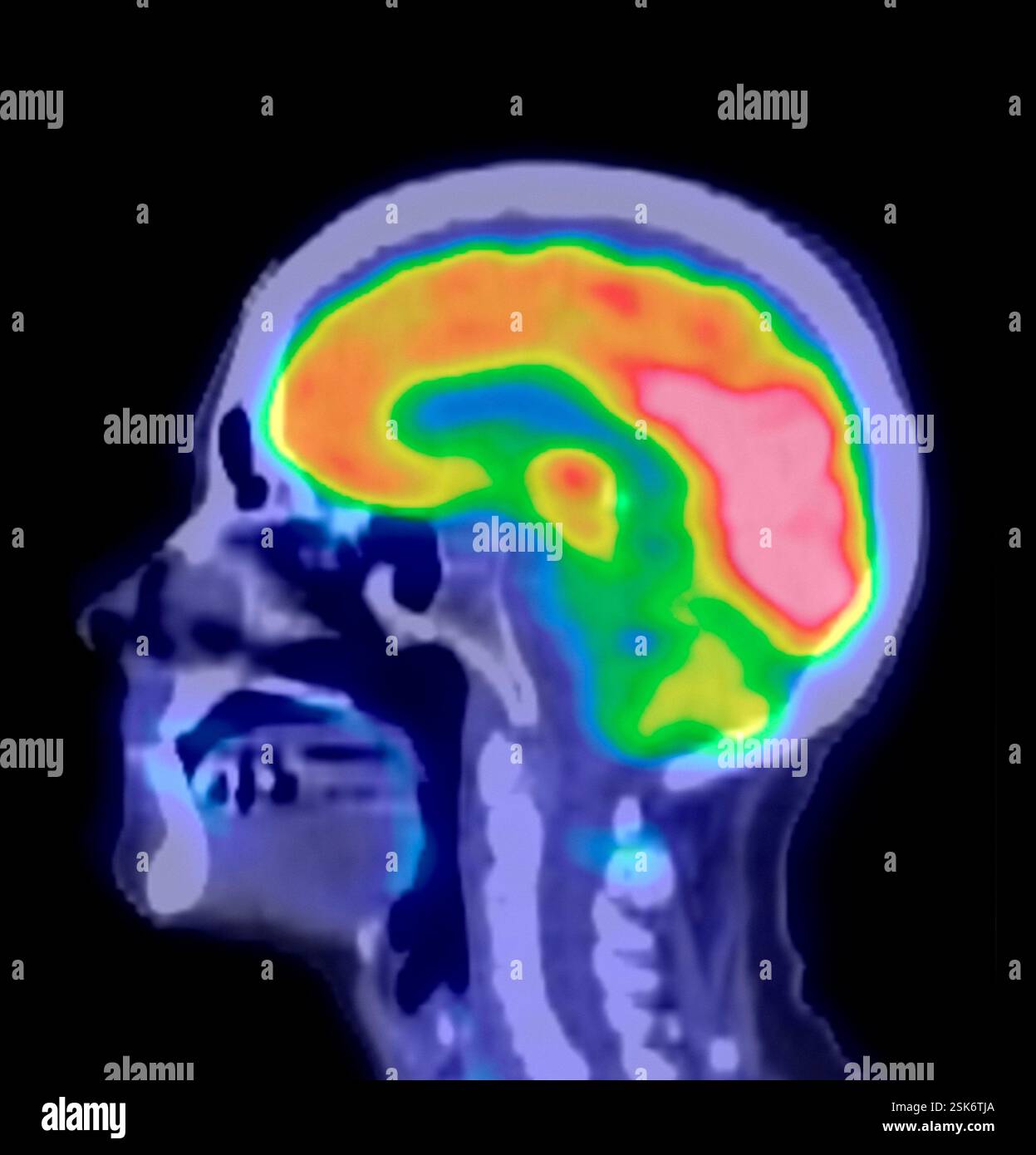 Human brain, combined computed tomography (CT) and positron emission ...
