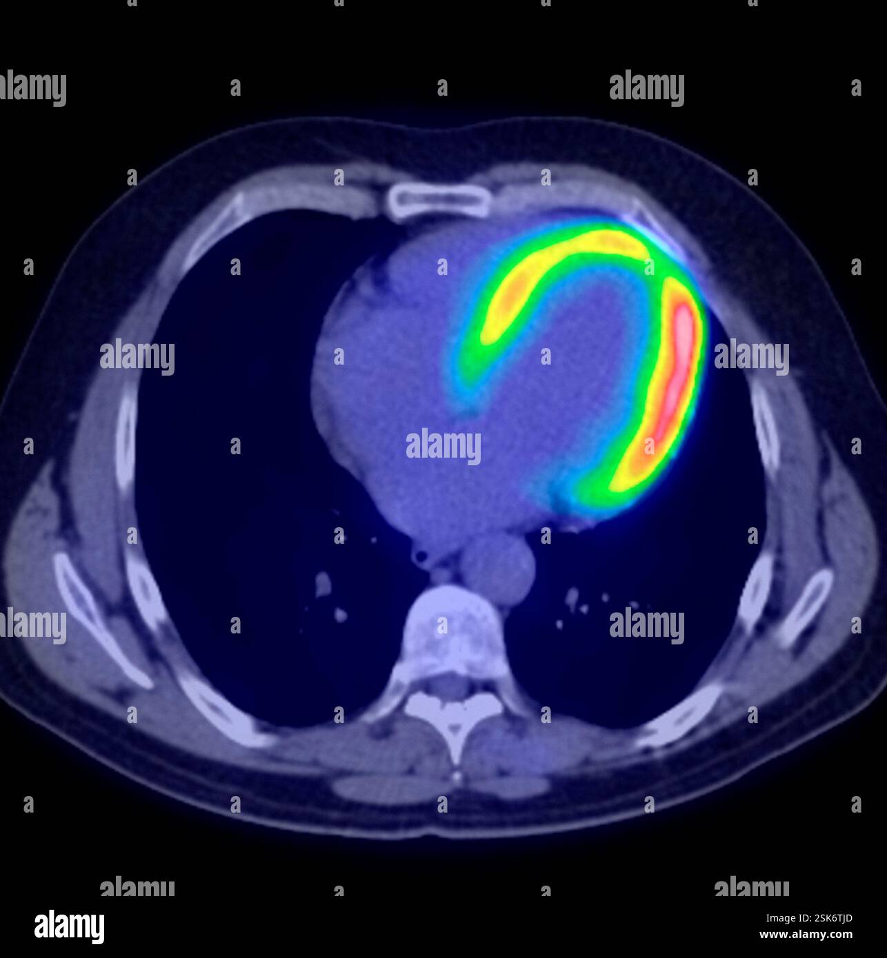 Cardiac insufficiency. Combined computed tomography (CT) and positron ...
