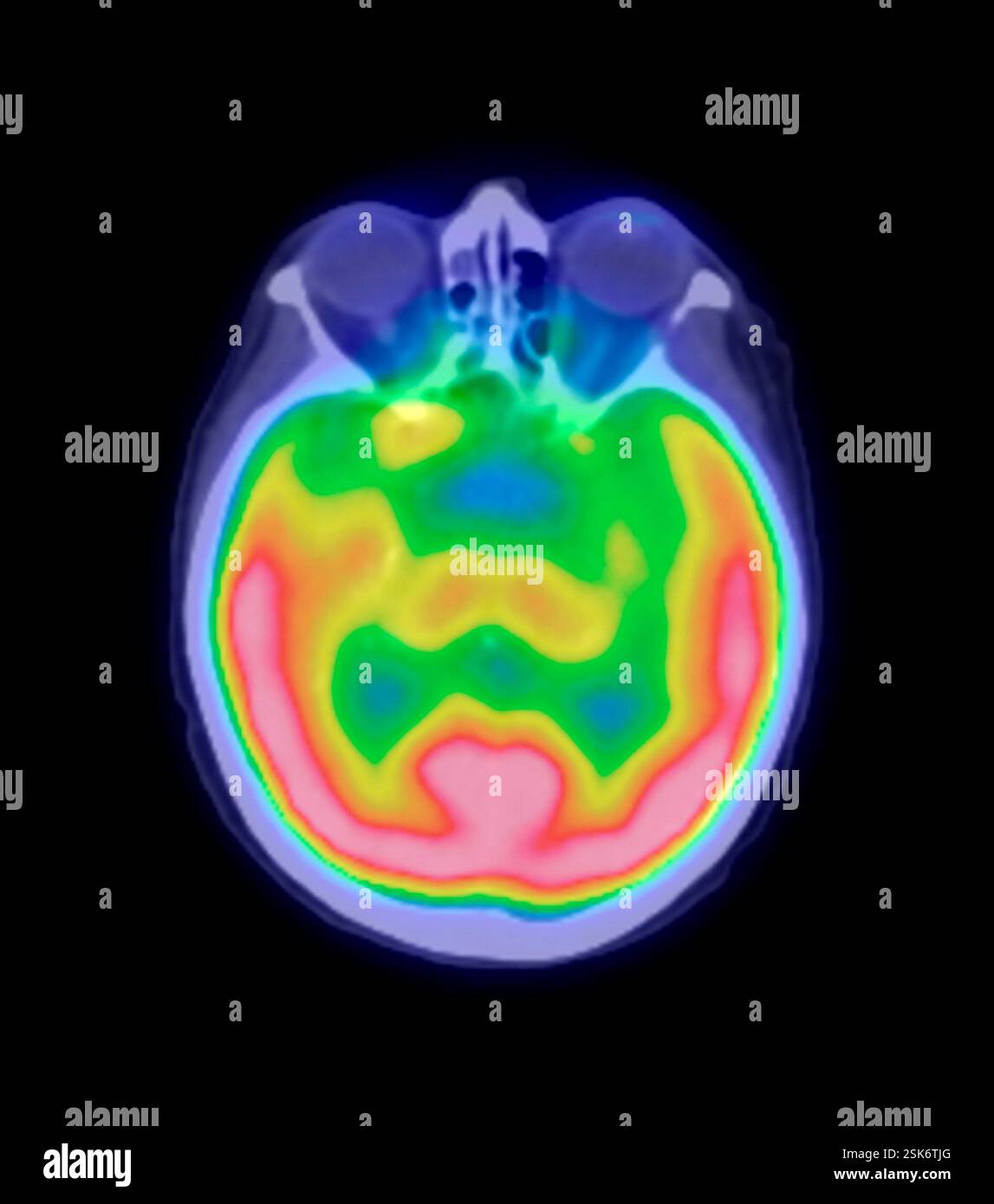 Human brain, combined computed tomography (CT) and positron emission ...