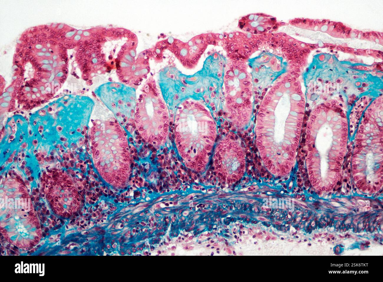 Collagenous colitis. Light micrograph of a section through the colon ...
