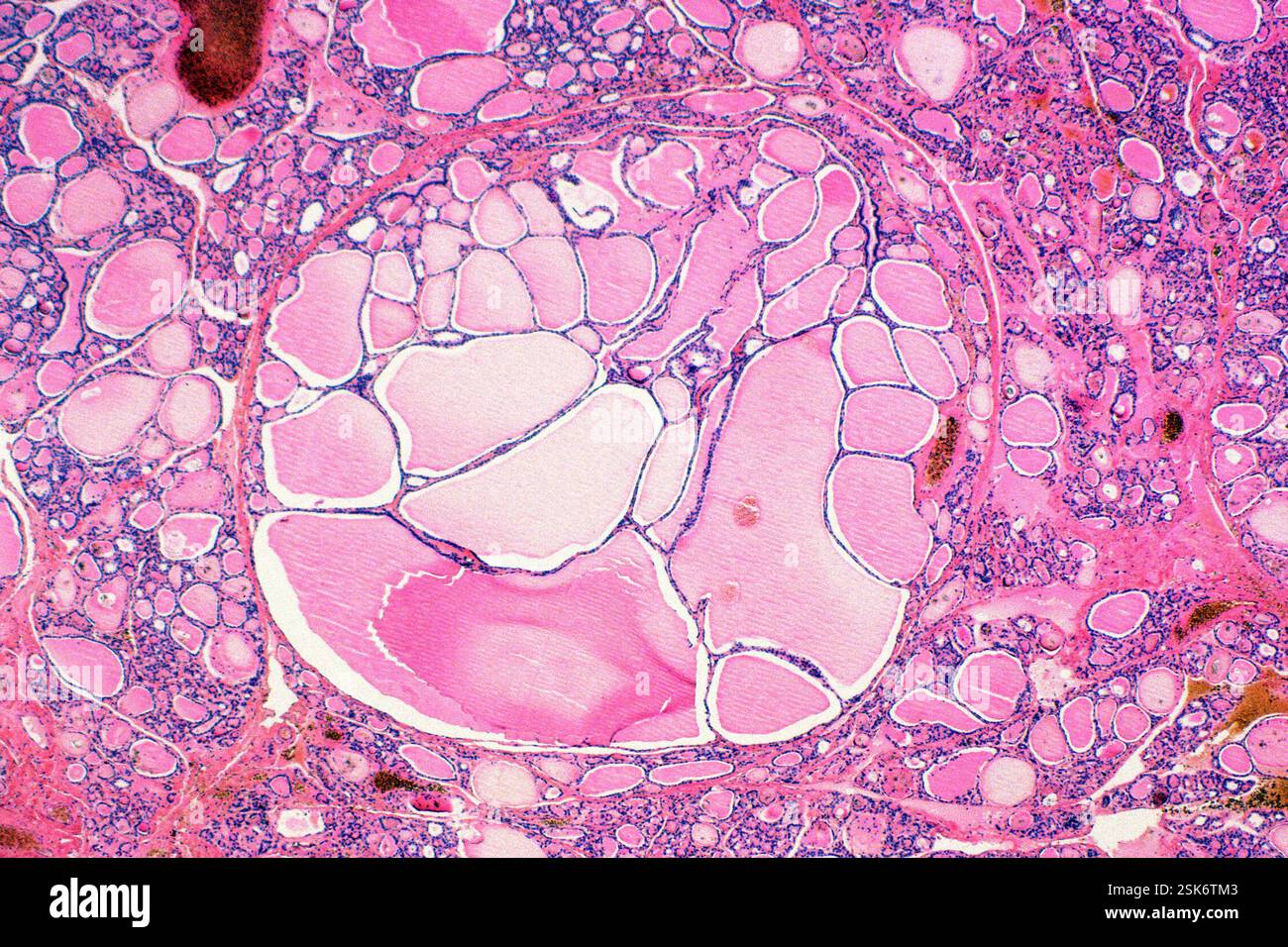 Narrowed coronary artery, X-ray Stock Photo - Alamy