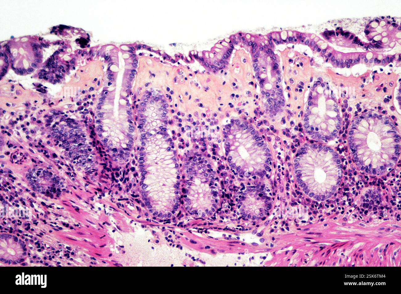 Collagenous colitis. Light micrograph of a section through the colon ...