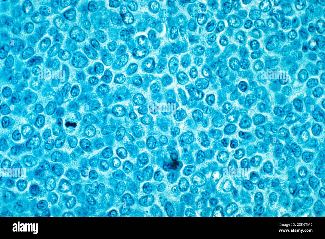 Thrombosis of a groin artery, MRI scan Stock Photo - Alamy