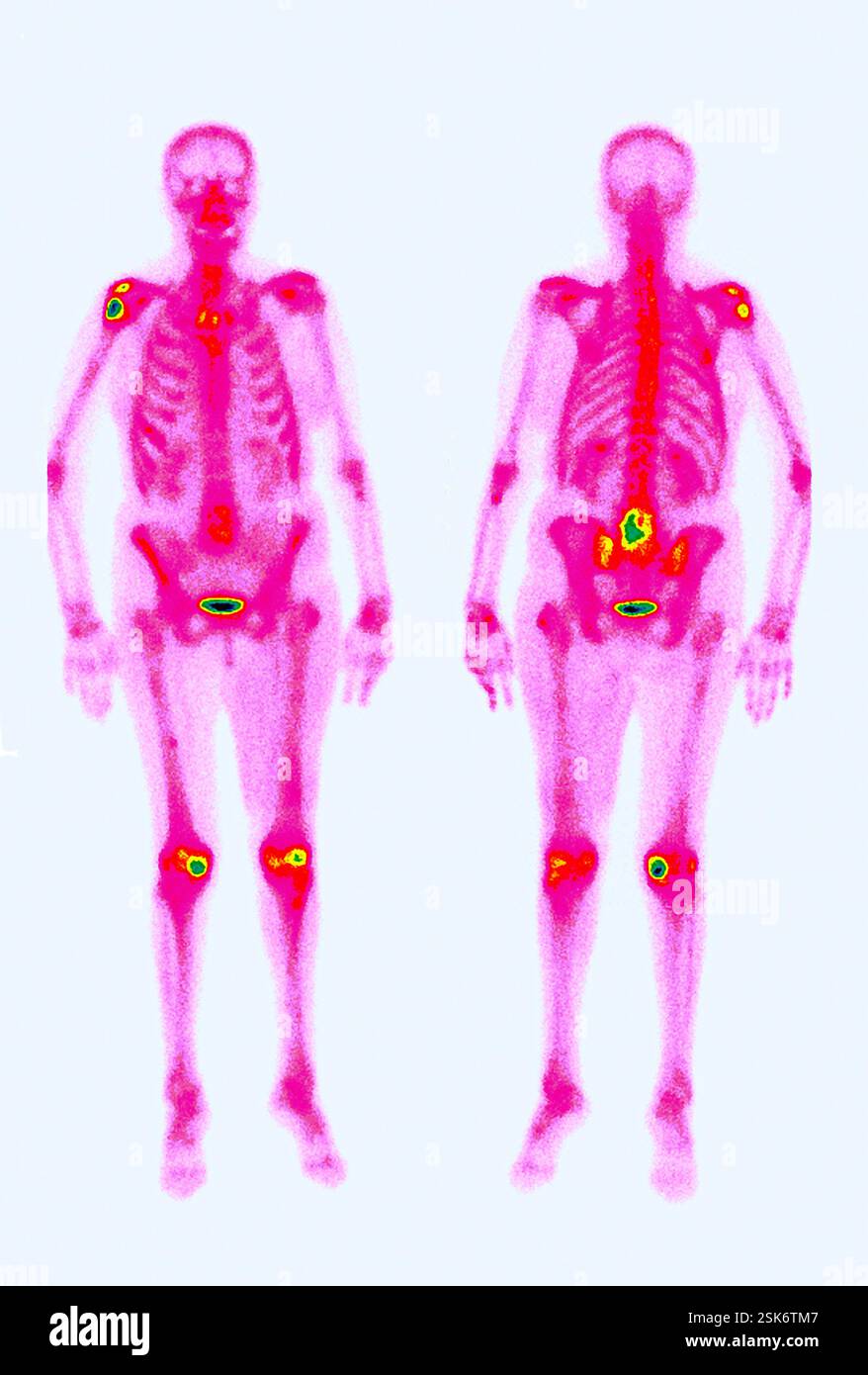 Bone cancer. Coloured gamma scan of the skeleton of a 67-year-old woman ...