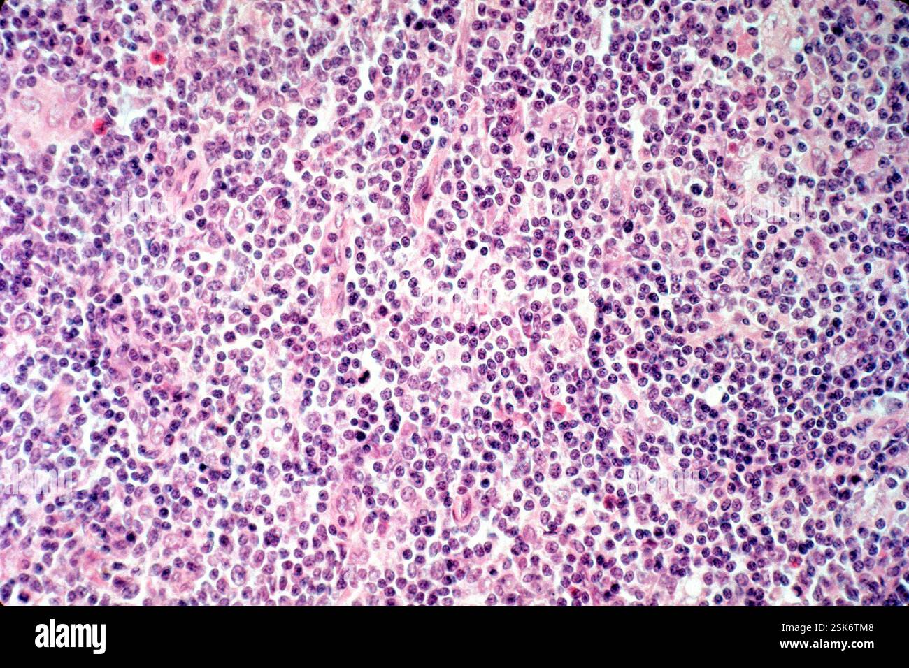 Thrombosis of leg arteries, MRI scan Stock Photo - Alamy