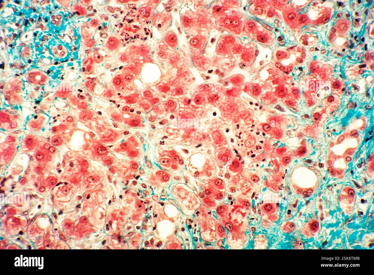 Spinal collapse treatment, X-ray Stock Photo - Alamy