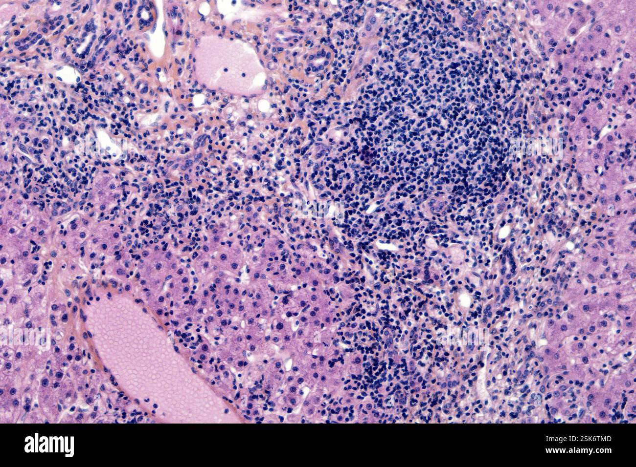 Hepatitis C. Light micrograph of a section through a liver affected by ...