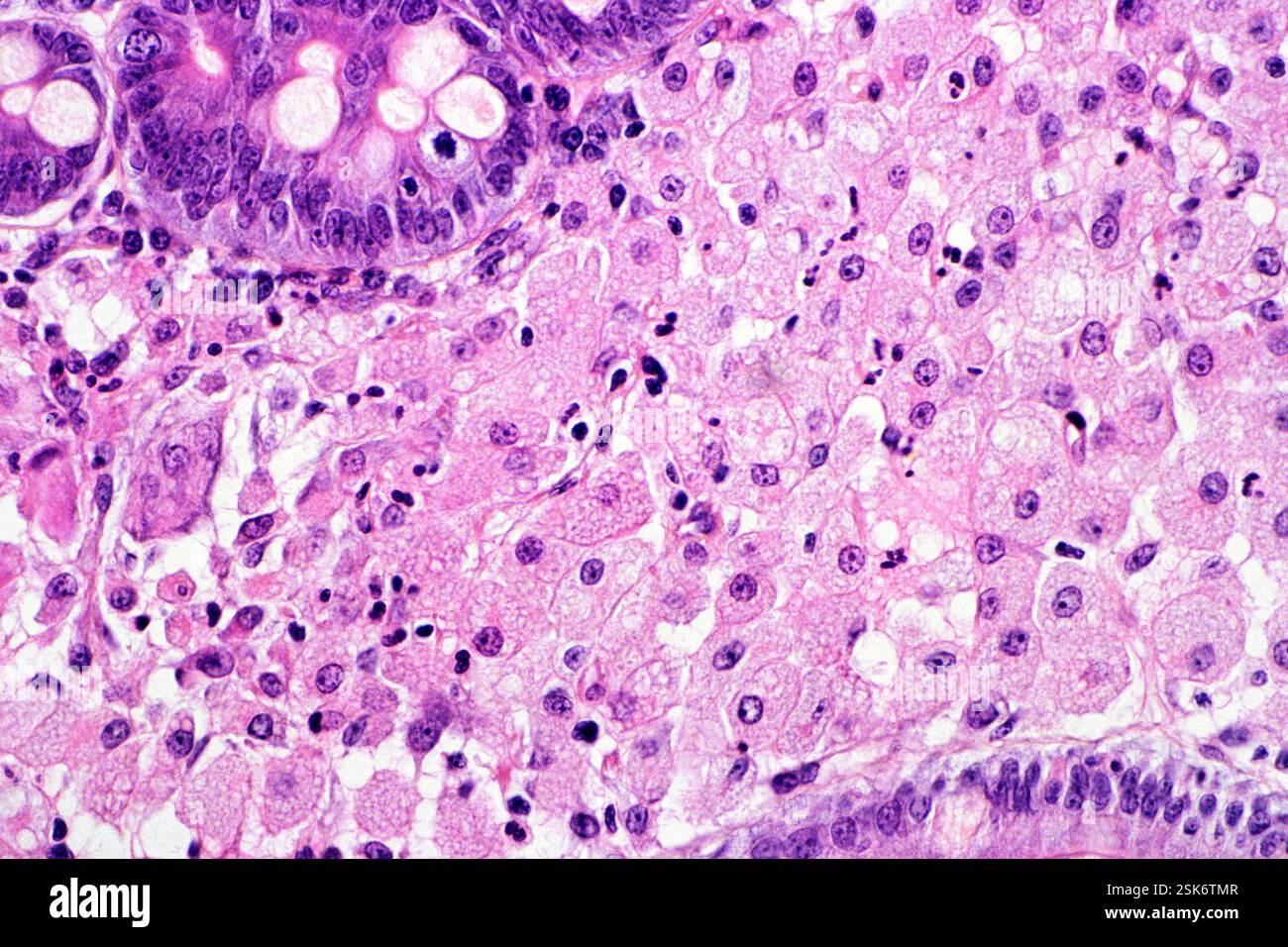 Whipple's disease. Light micrograph of a section through the intestine ...
